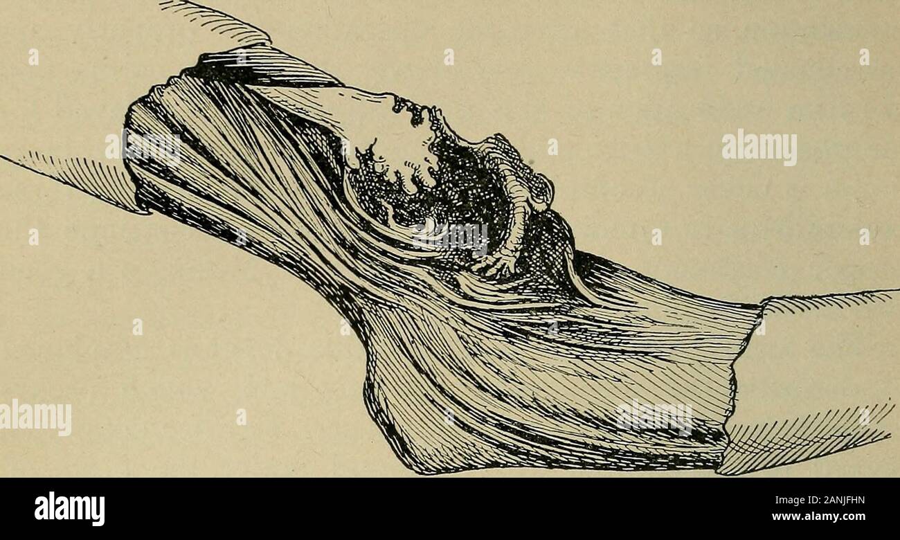 Atlas and epitome of traumatic fractures and dislocations . Fig. 9 ...