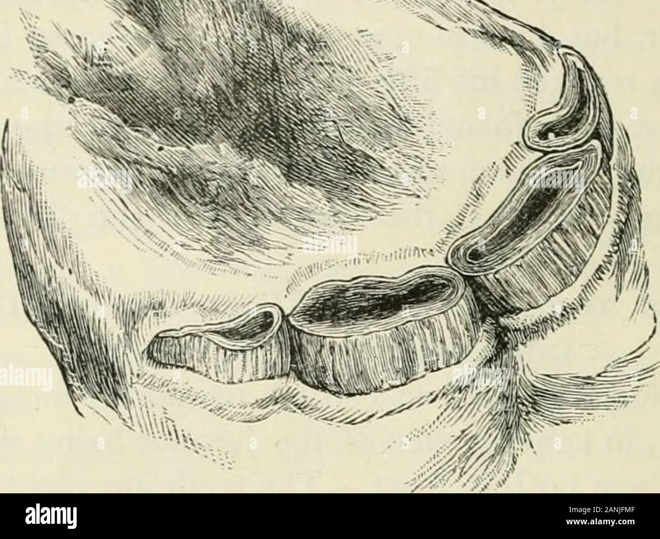 attrition teeth drawing