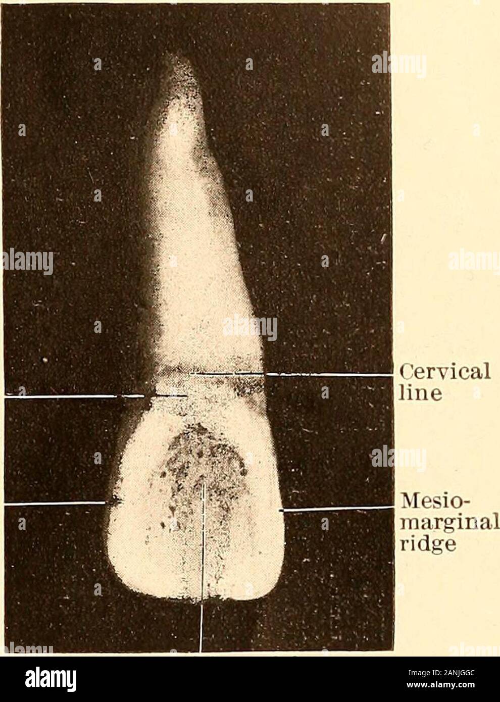 Principles and practice of operative dentistry . Cervical margin ...
