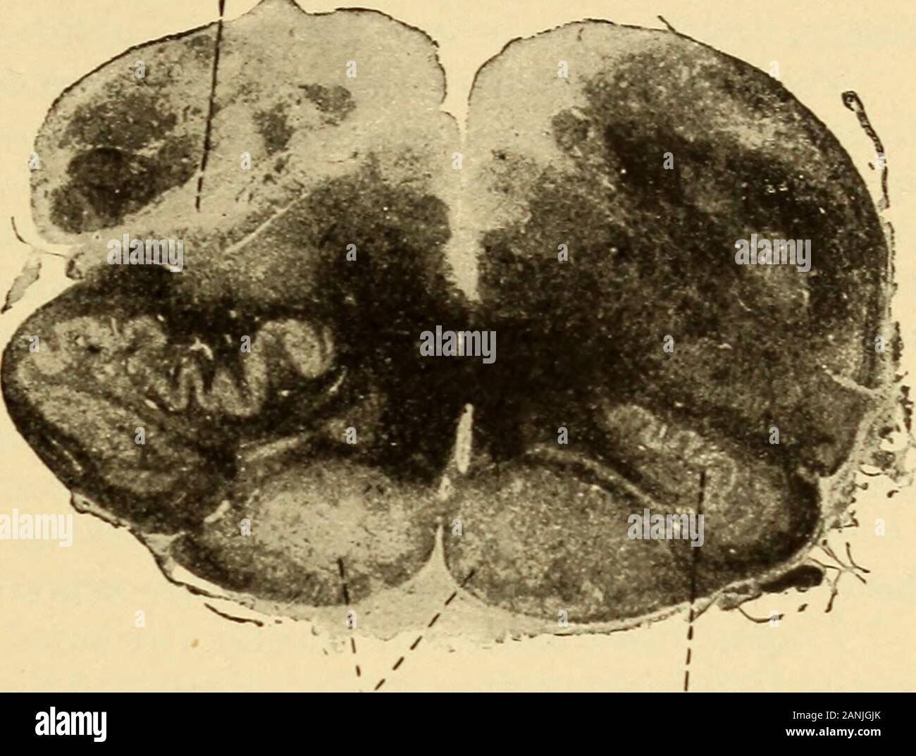 Syringomyelia Cross Section