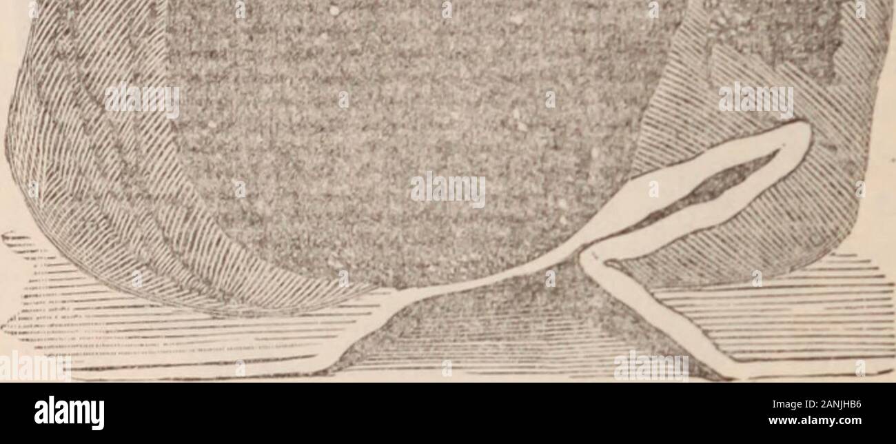 Virginia medical monthly . Interior of right lobe, showing extent of ...