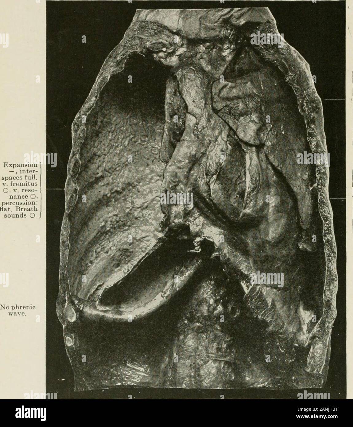 Pyothorax High Resolution Stock Photography and Images - Alamy