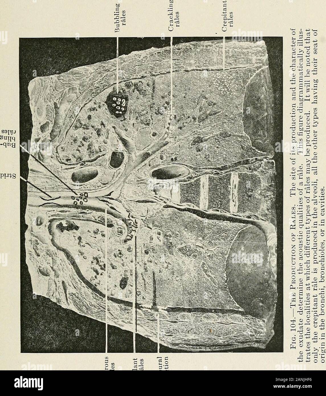 Pulmonary rales hi-res stock photography and images - Alamy