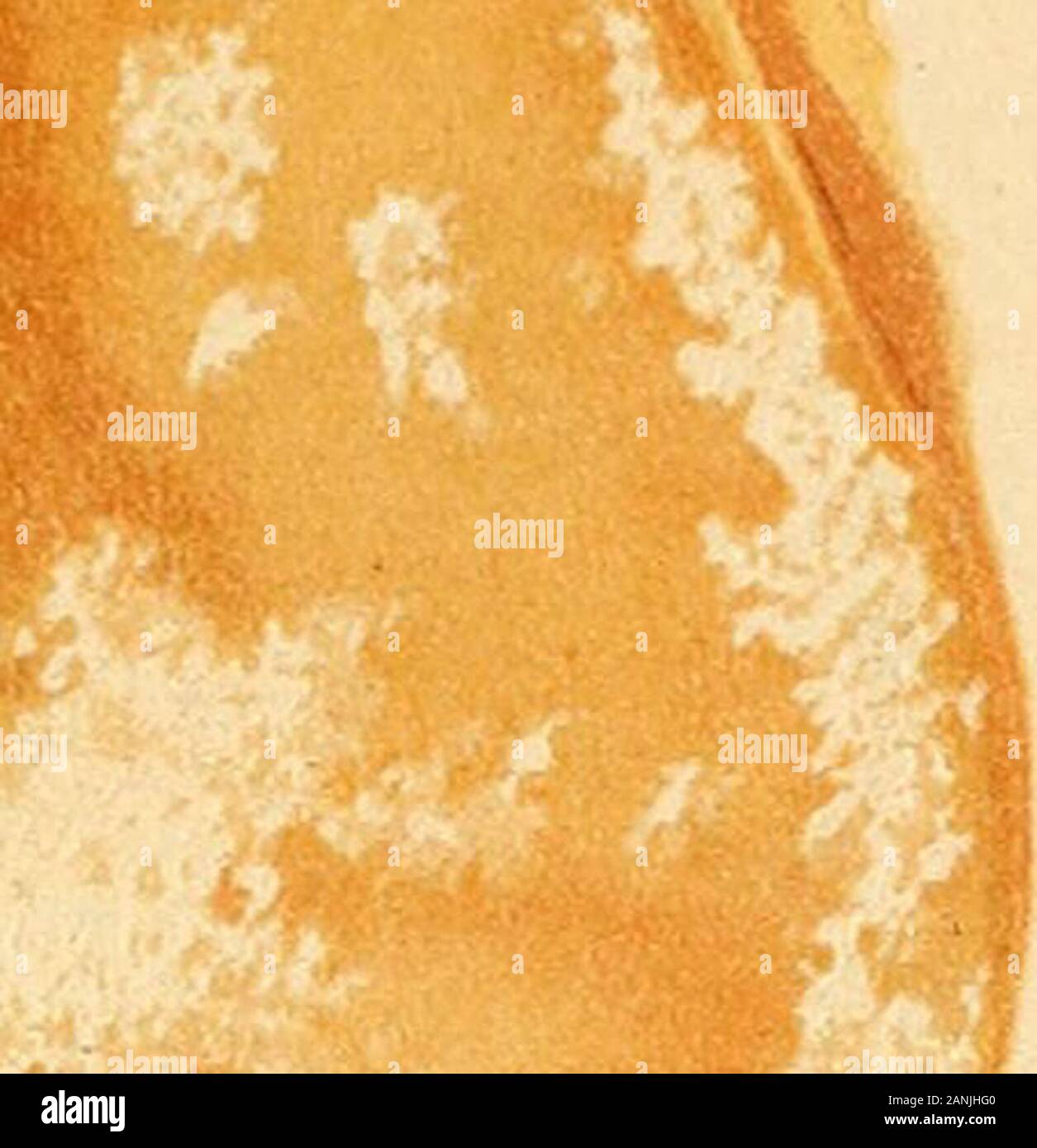 Gicht hi-res stock photography and images - Alamy