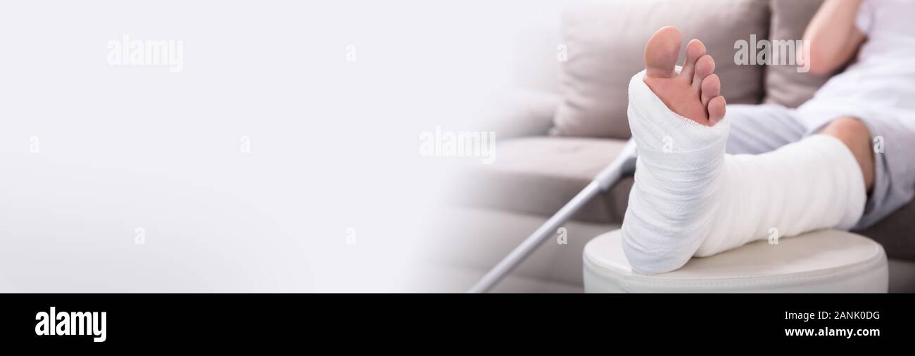 Bone fracture plaster hi-res stock photography and images - Alamy