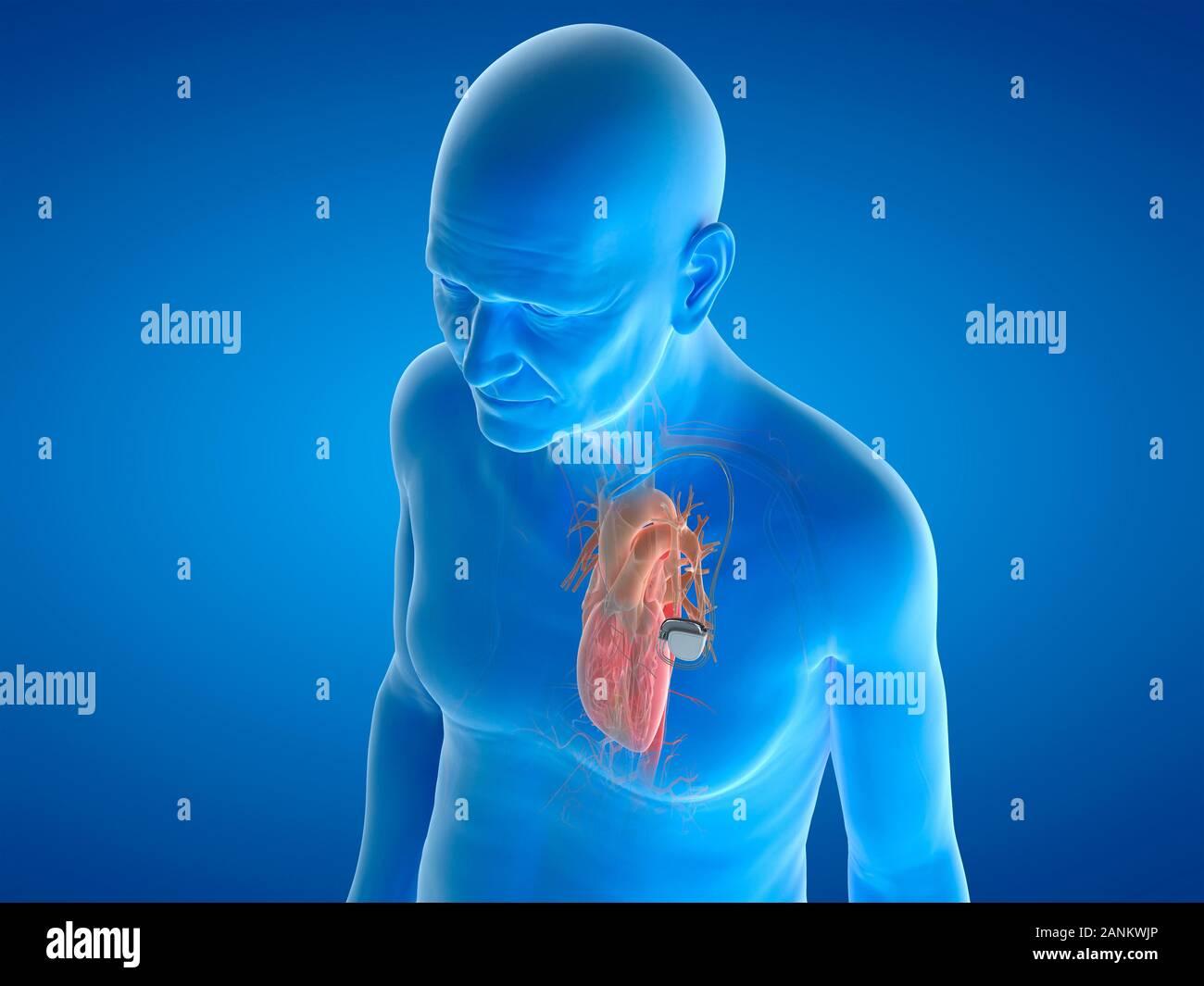 Illustration of an old man with a pace maker Stock Photo - Alamy
