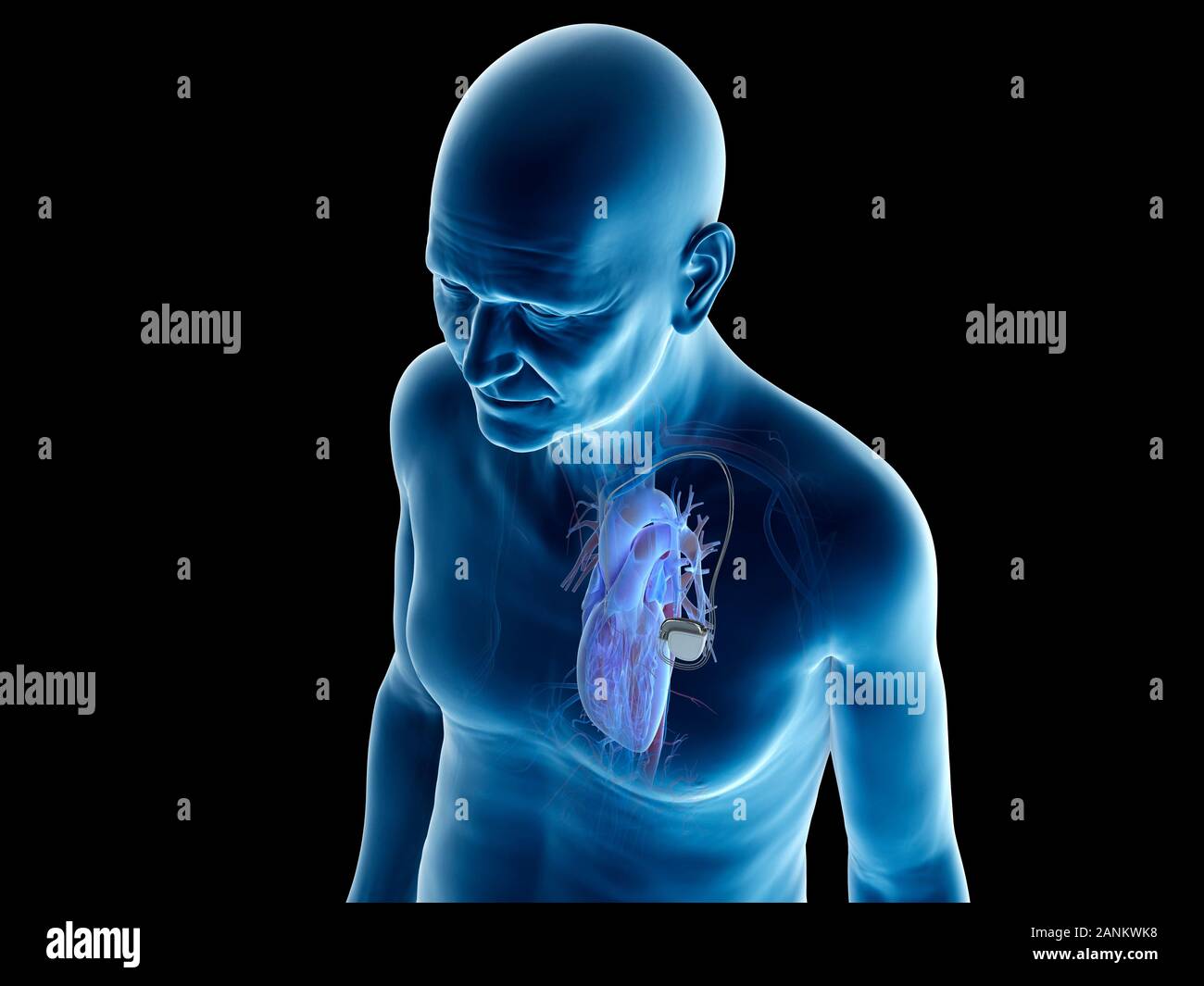 Illustration of an old man with a pace maker Stock Photo - Alamy