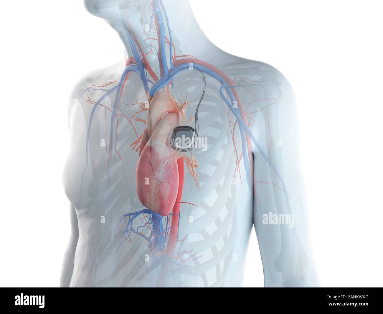 Illustration of an old man with a pace maker Stock Photo - Alamy