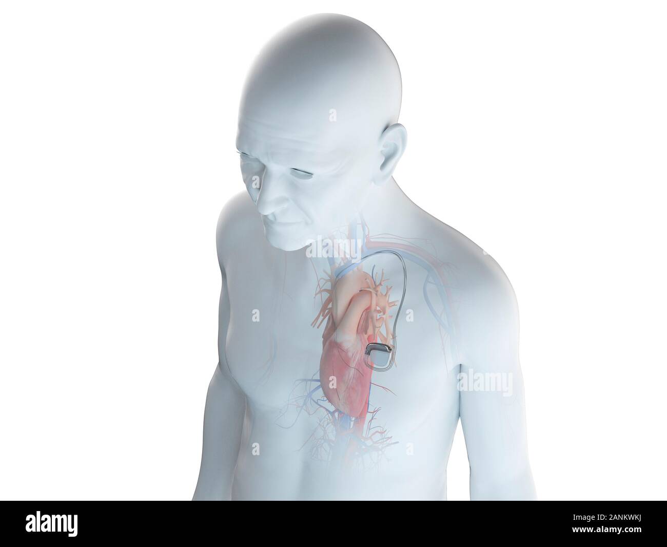 Illustration of an old man with a pace maker Stock Photo - Alamy