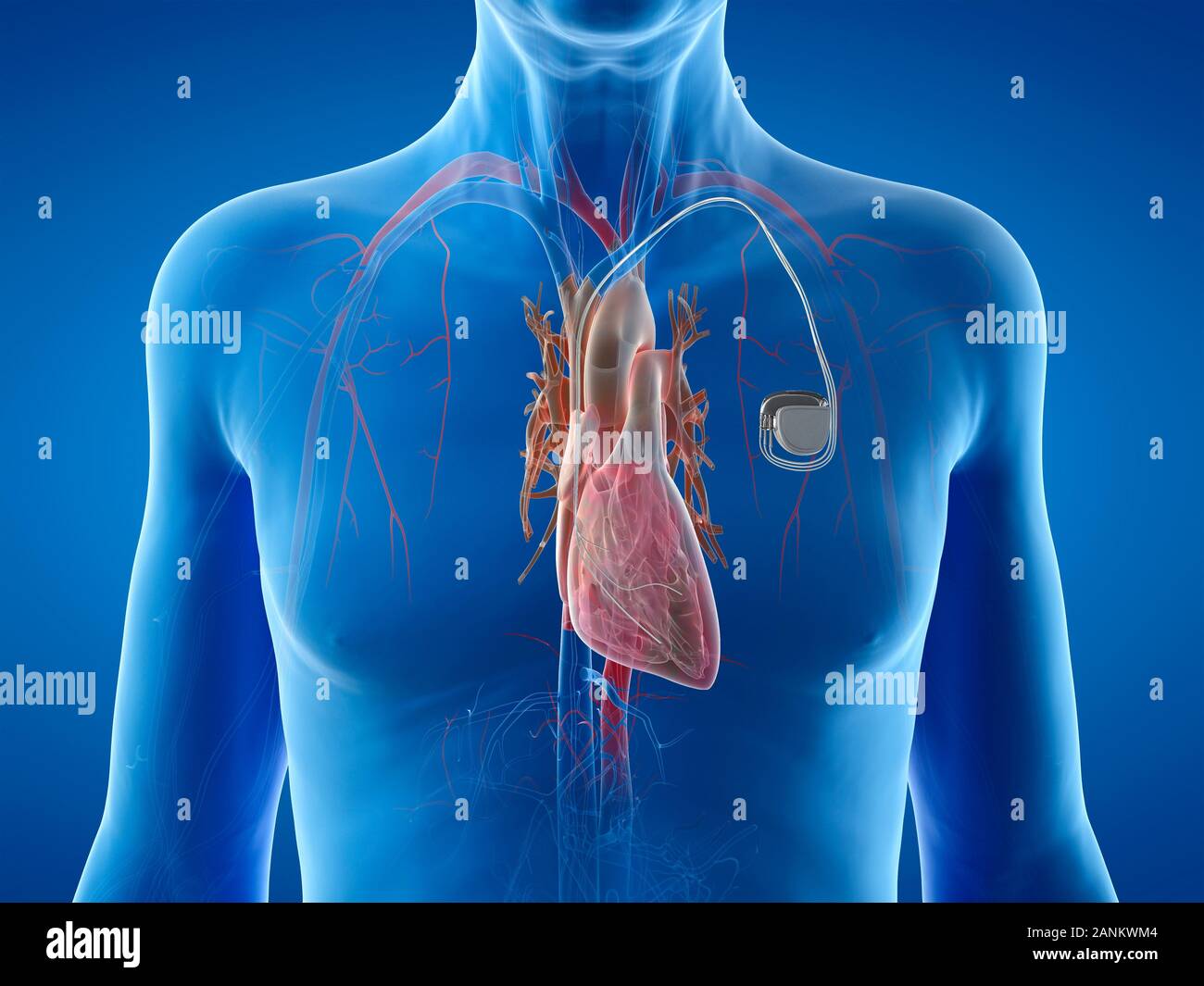 Pace maker heart hi-res stock photography and images - Alamy