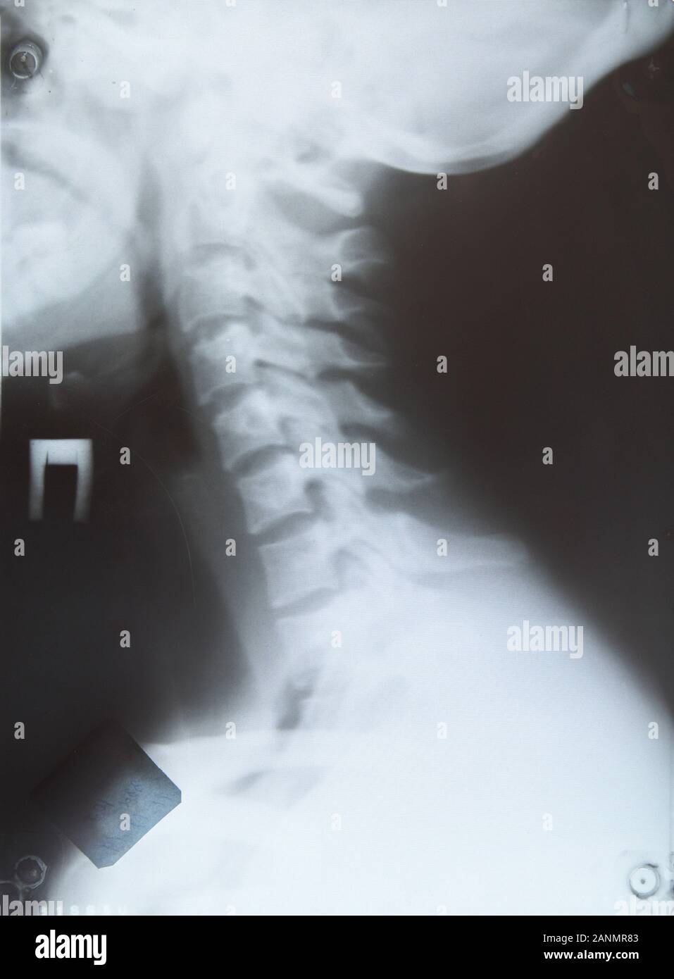 Xray of neck surgery hi-res stock photography and images - Alamy
