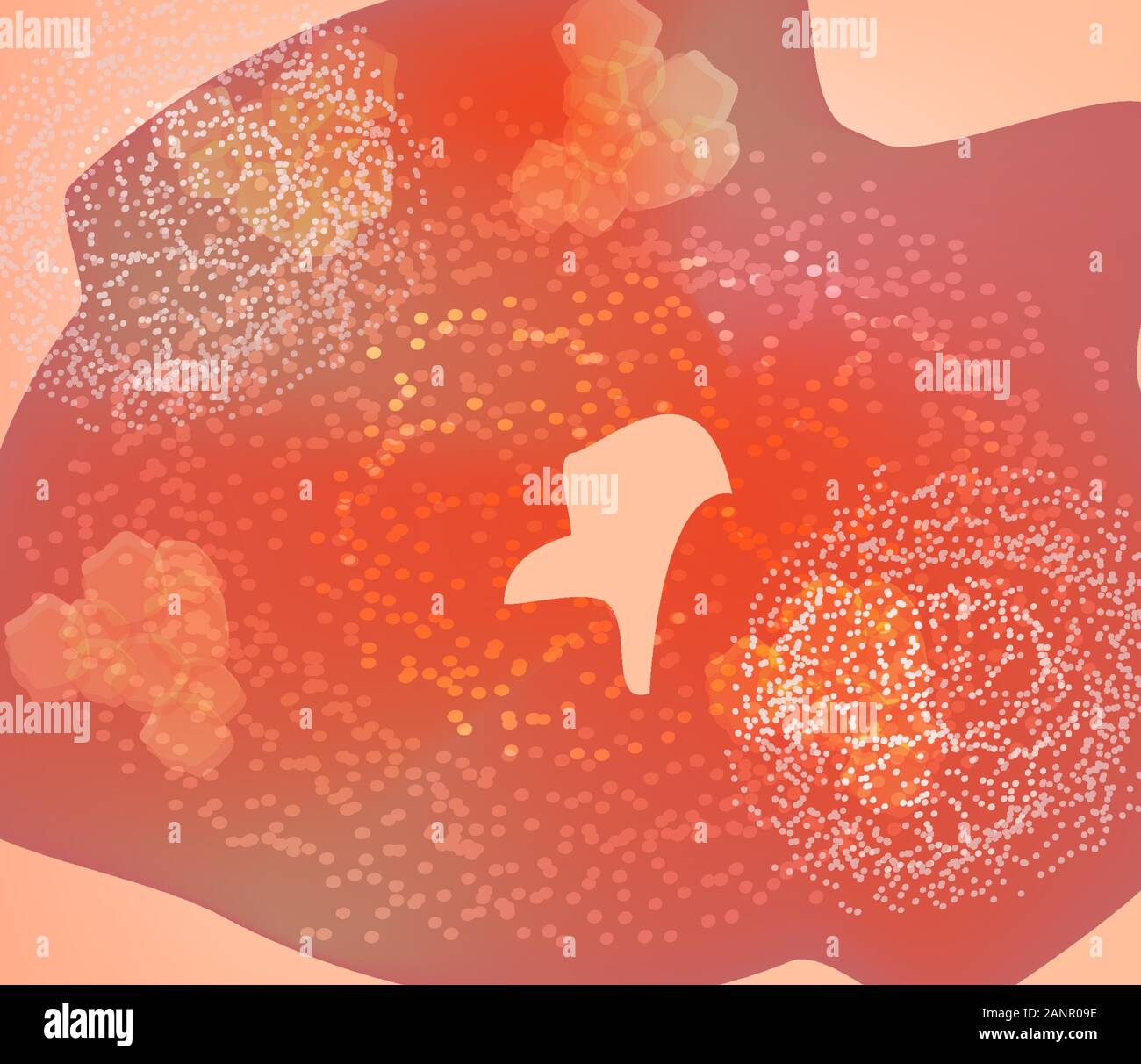 Erythrodermic psoriasis texture. Eczema, dermatitis skin disease ...