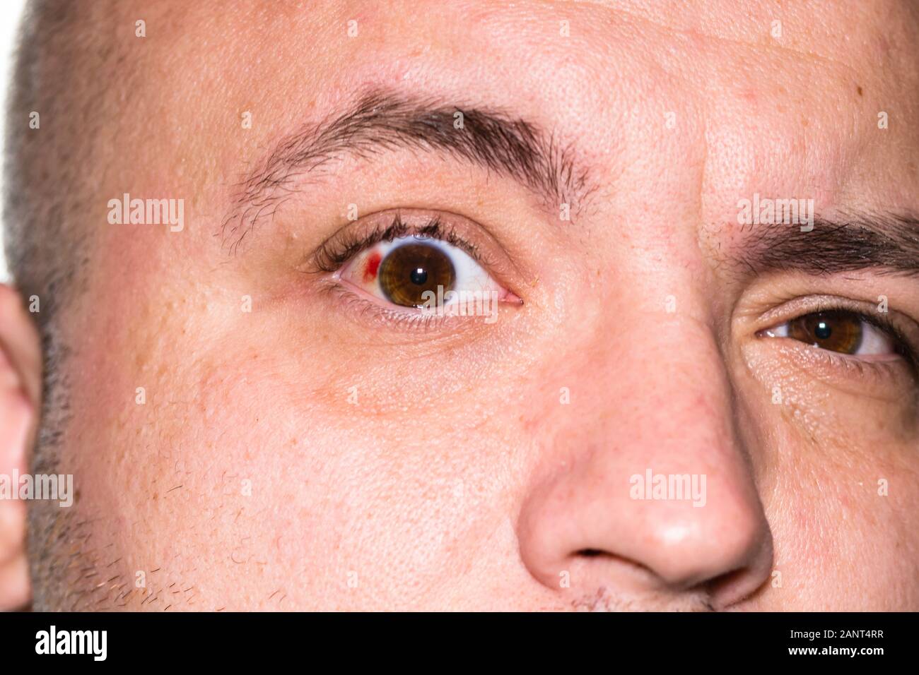 Blood in sclera hi-res stock photography and images - Alamy