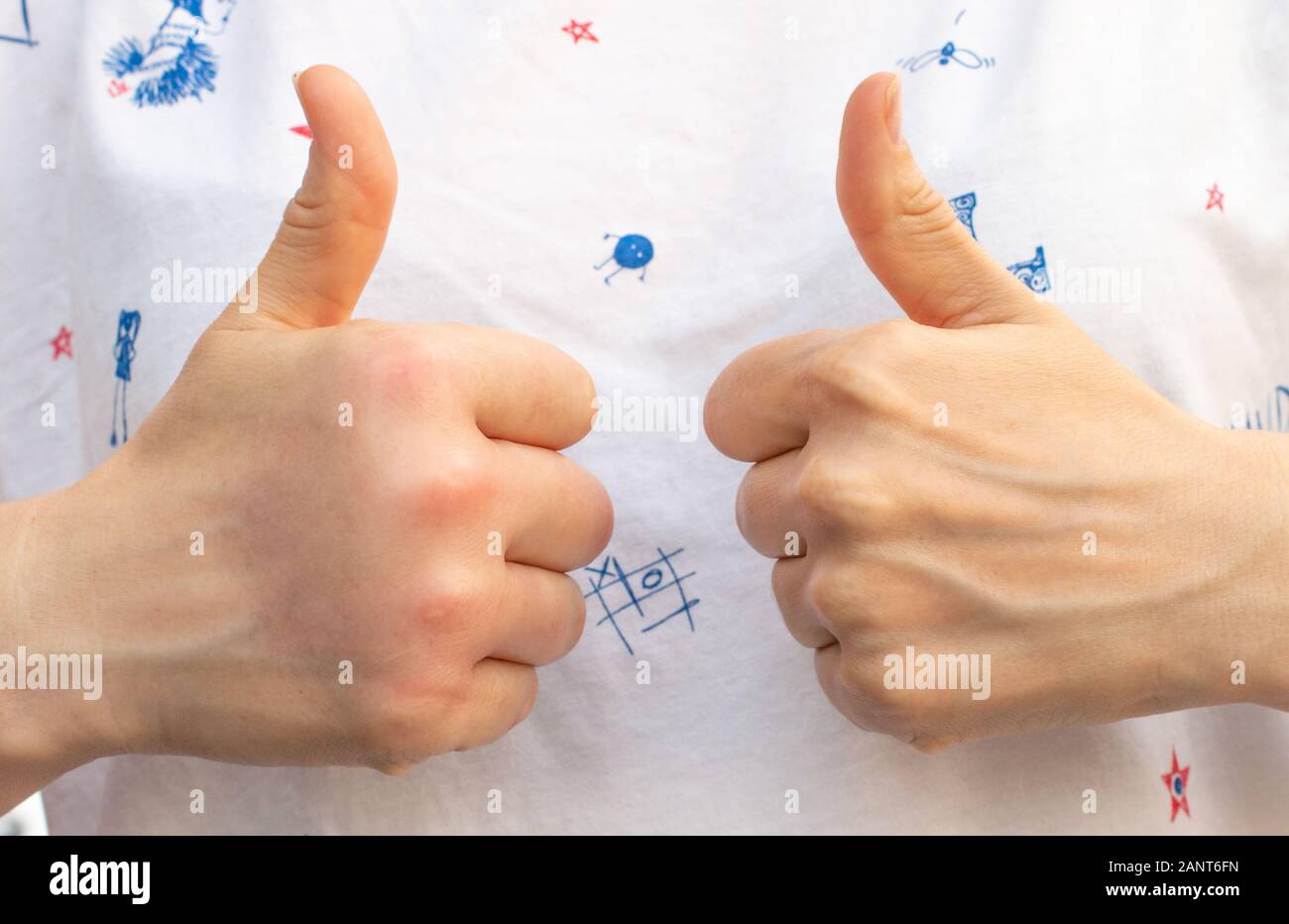 a right hand with a swollen palm compared to a normal size left hand ...