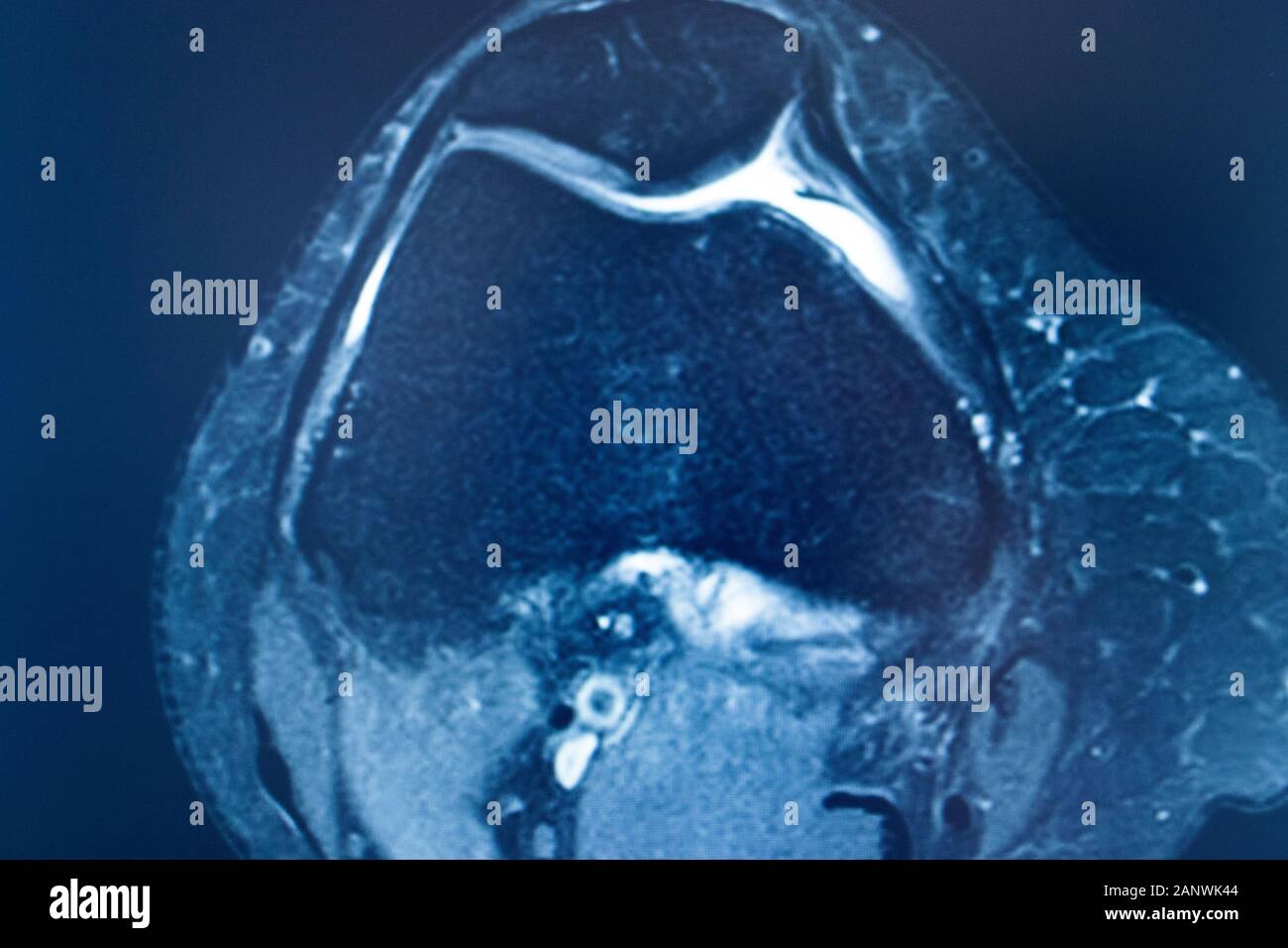 Knee sports injury mri mcl grade 2 tear magnetic resonance imaging ...