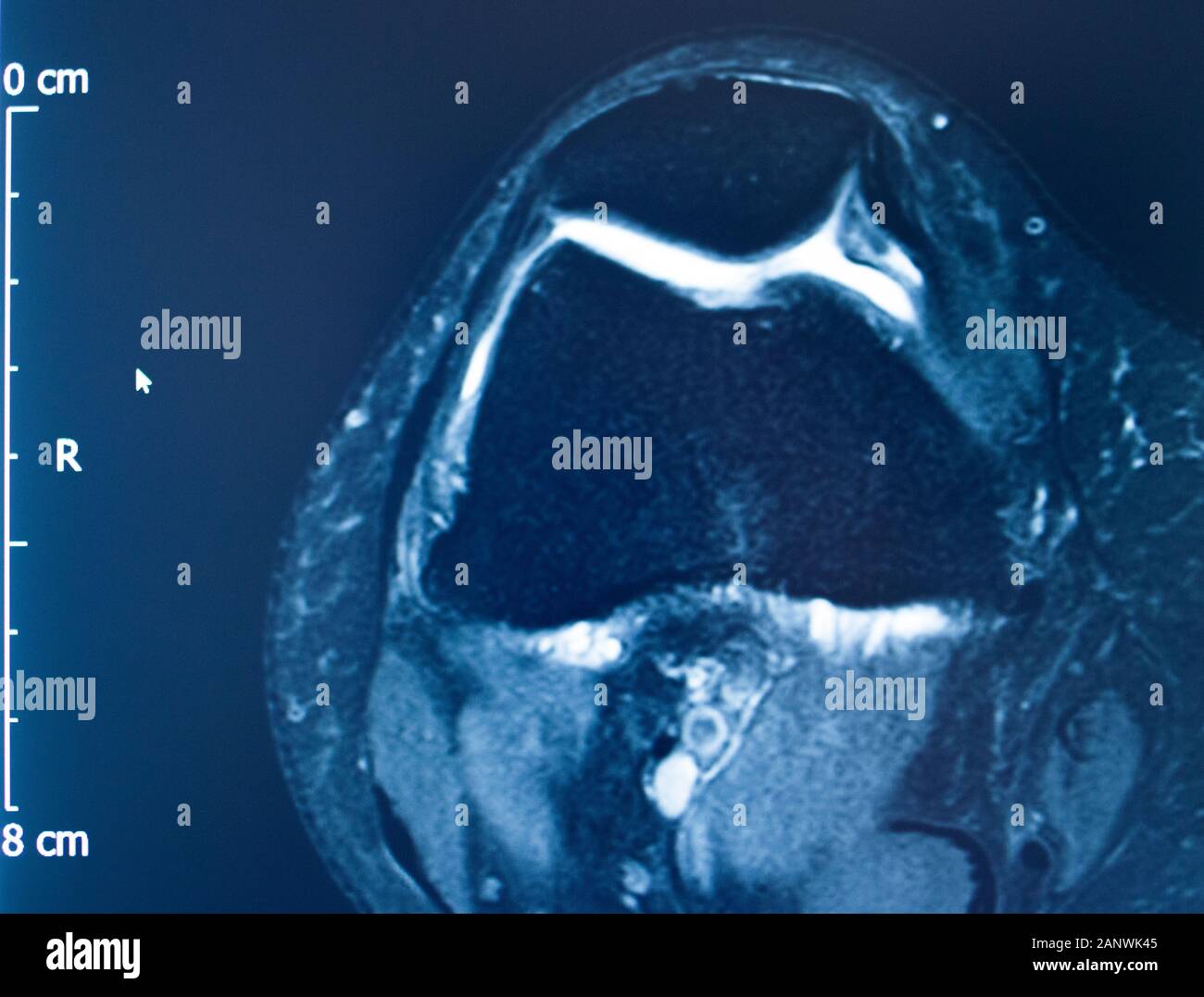 Knee sports injury mri mcl grade 2 tear magnetic resonance imaging ...