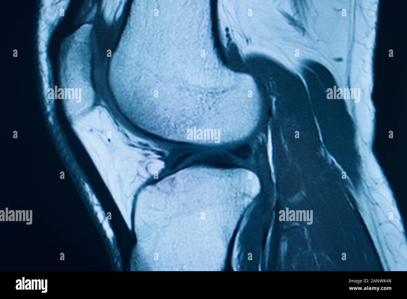 Knee sports injury mri mcl grade 2 tear magnetic resonance imaging ...