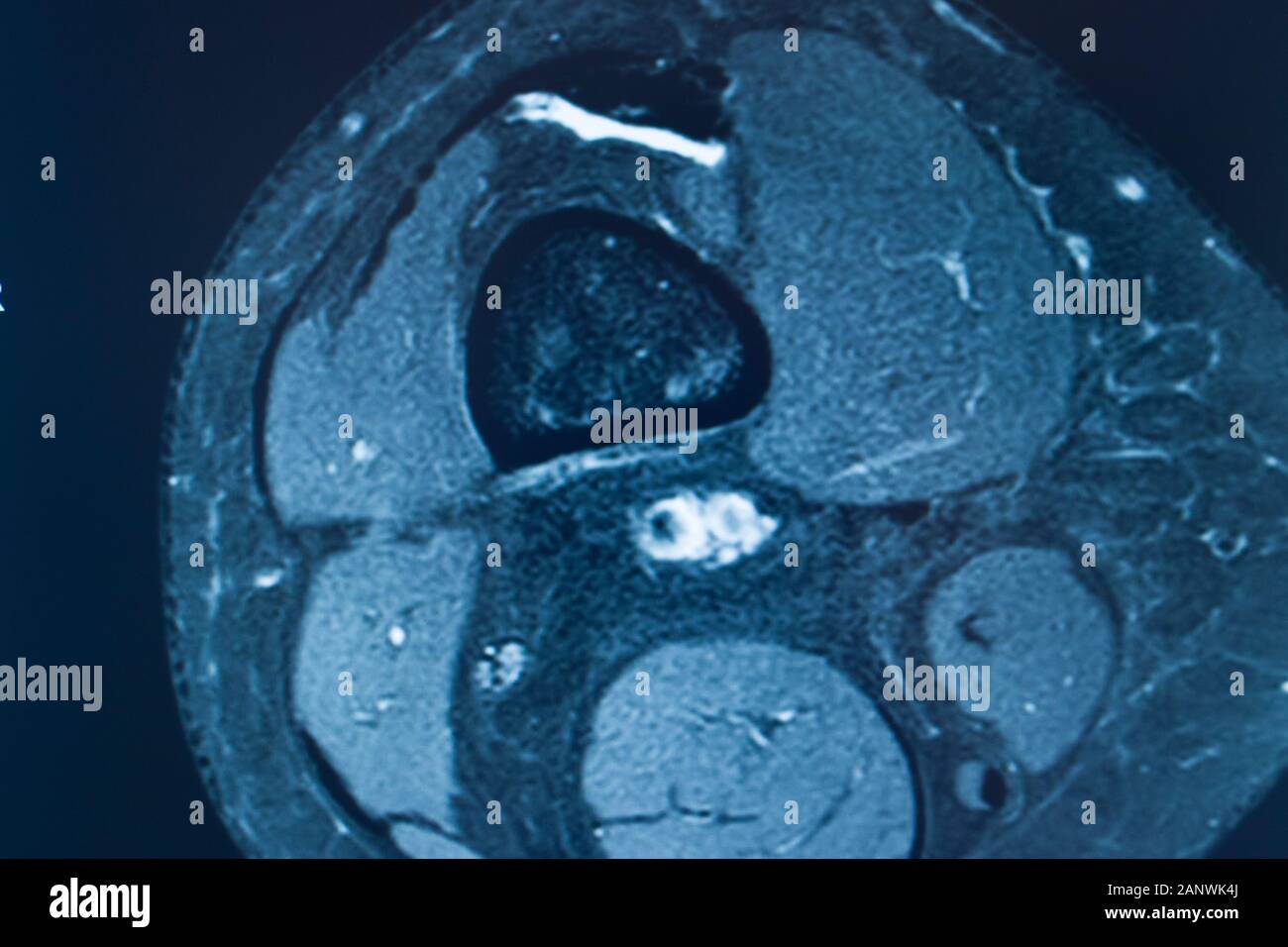 Knee sports injury mri mcl grade 2 tear magnetic resonance imaging ...