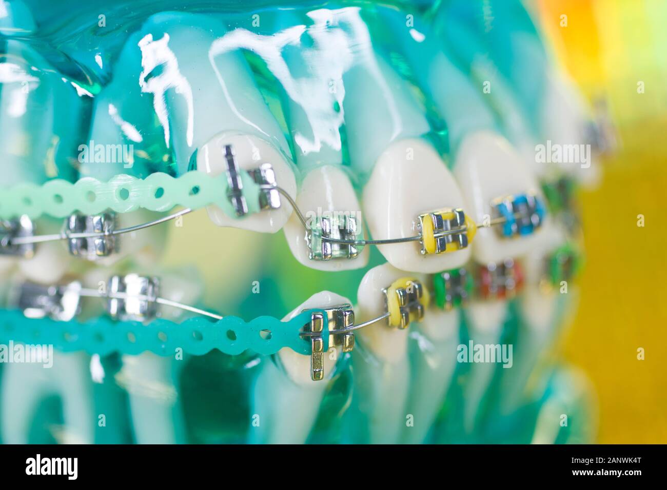 Modern metal retainers and plastic algners wire dental brackets teeth ...