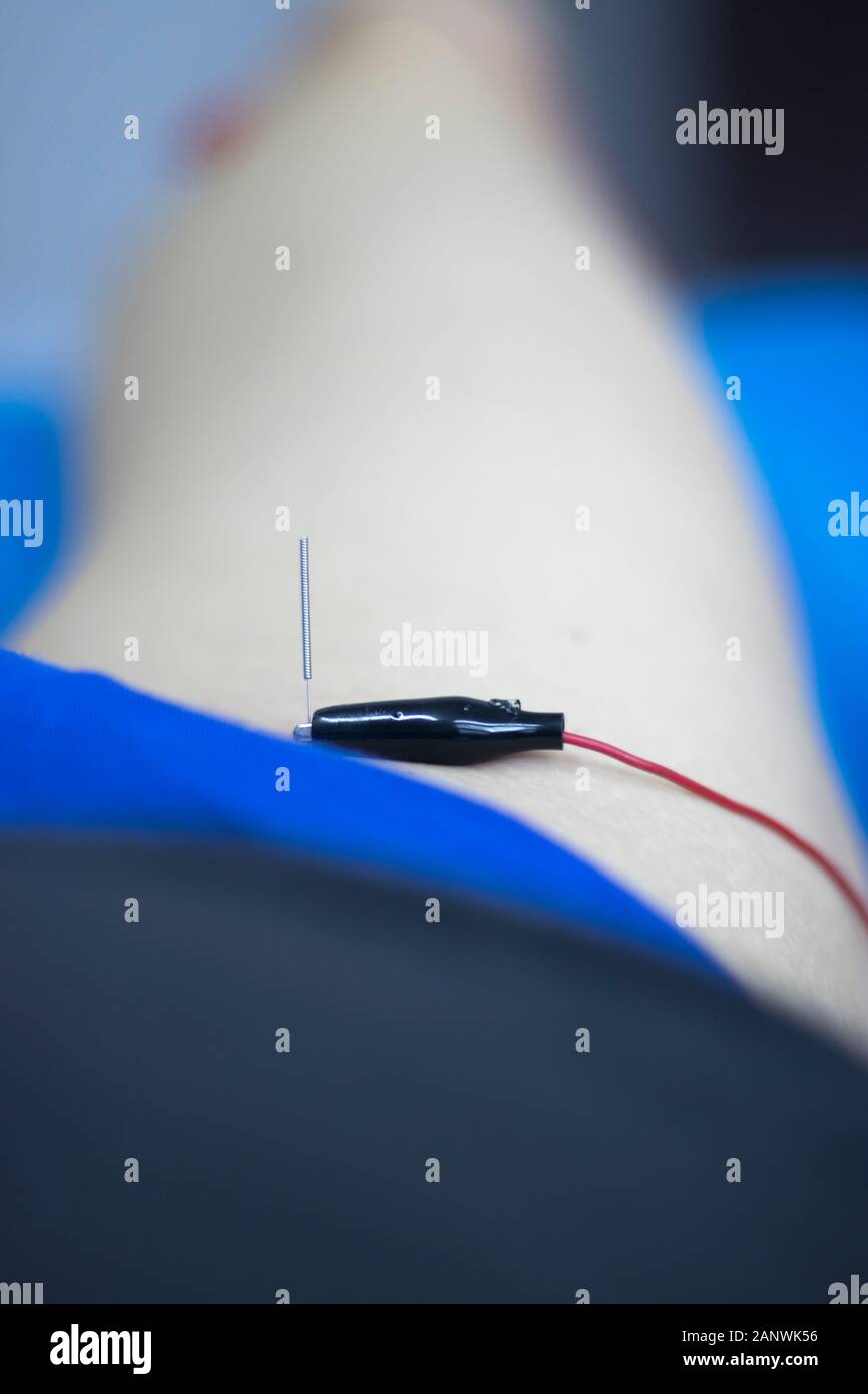 EPI Intratissue Percutaneous Electrolysis dry needling ultrasound ecography scan physiotherapy ...