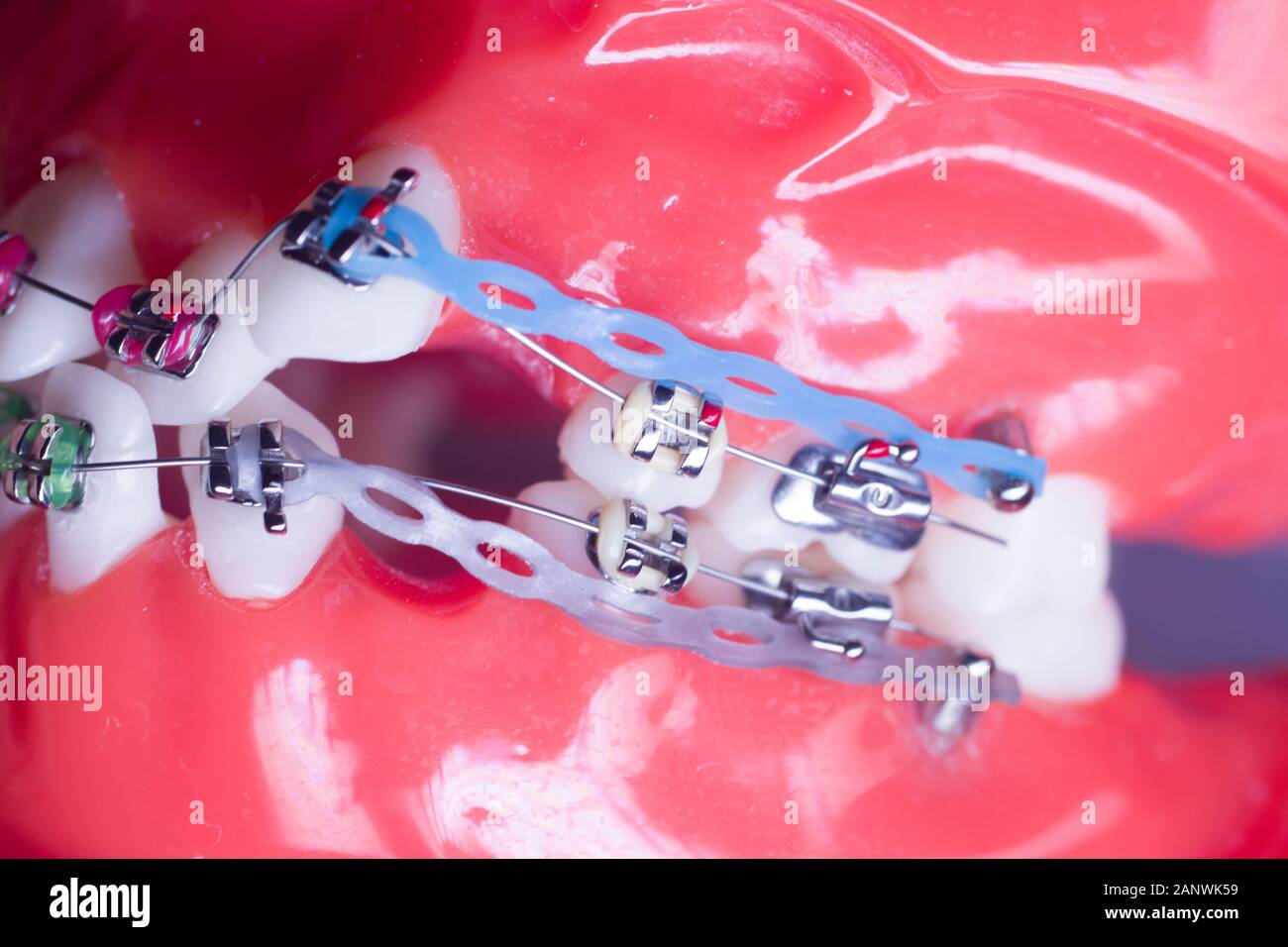 Modern metal retainers and plastic algners wire dental brackets teeth ...