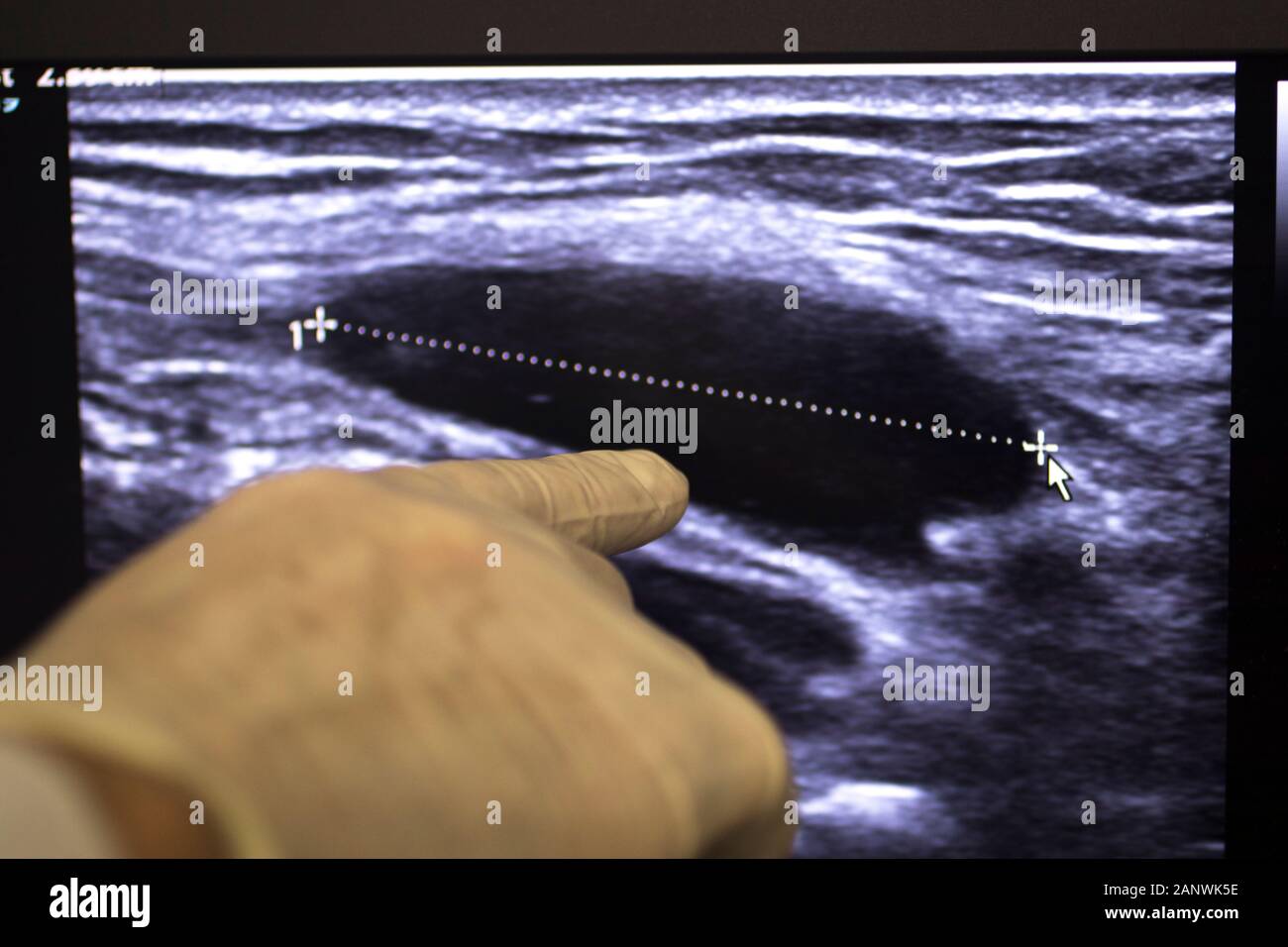 EPI Intratissue Percutaneous Electrolysis dry needling ultrasound ecography scan physiotherapy ...