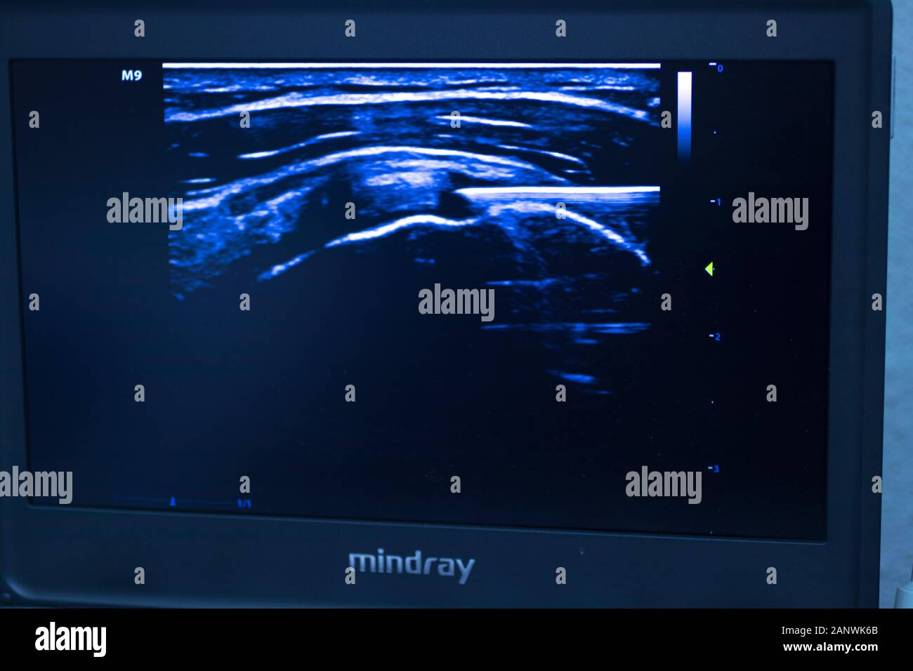 EPI Intratissue Percutaneous Electrolysis dry needling ultrasound ...