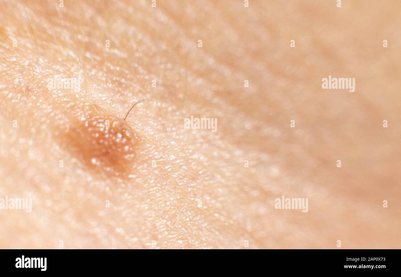 Mole mole on the skin of a person, dermatology, background, copy space ...