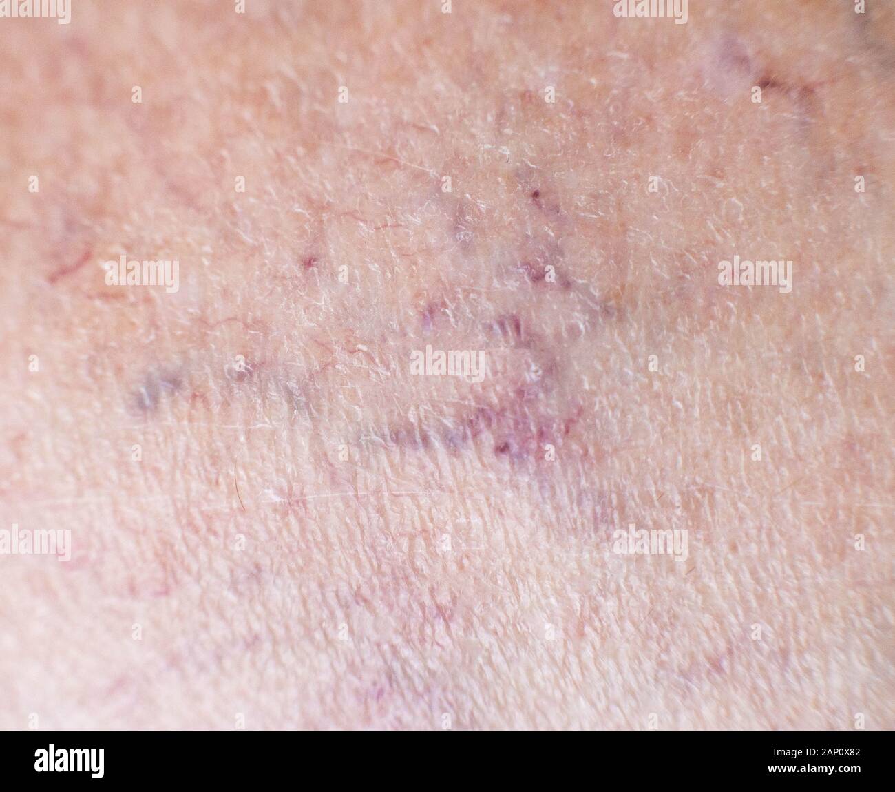 Vascular asterisk on the patient s skin. The concept of varicose veins ...