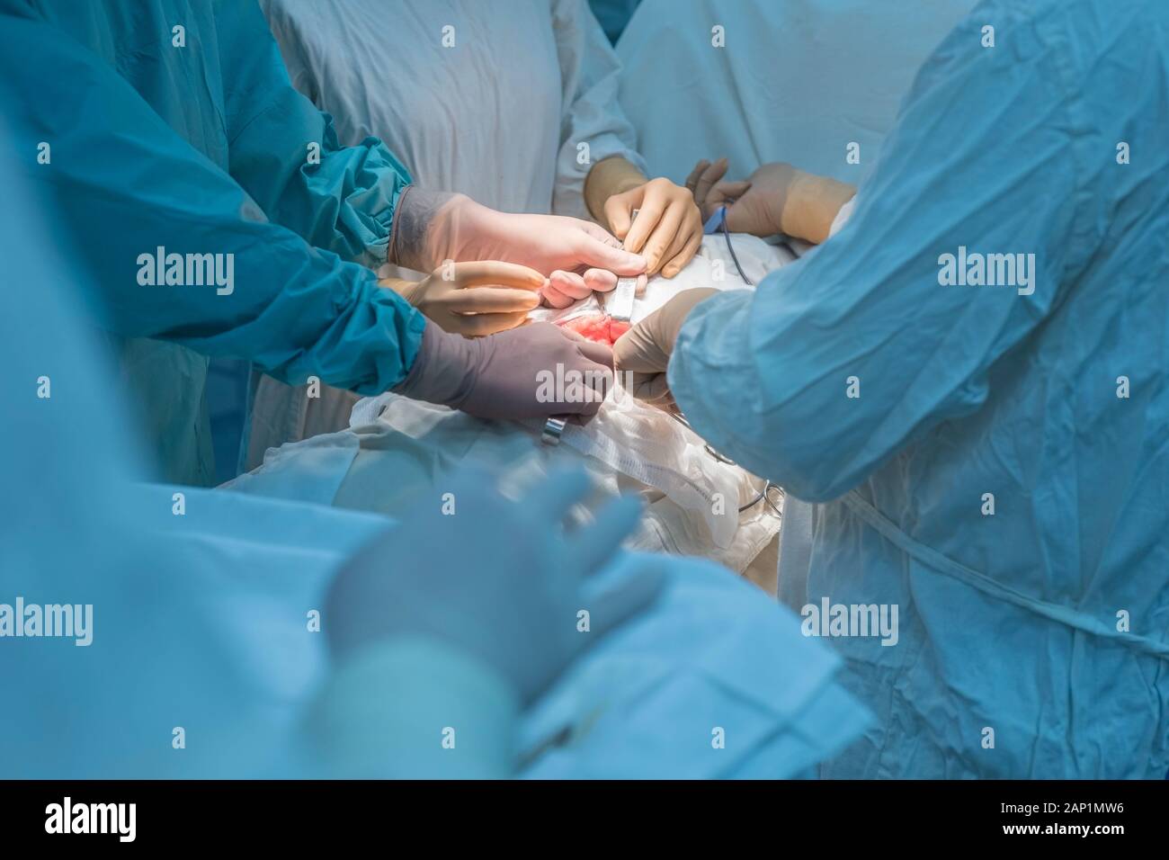 A team of surgeons perform a kidney operation in a sterile operating ...