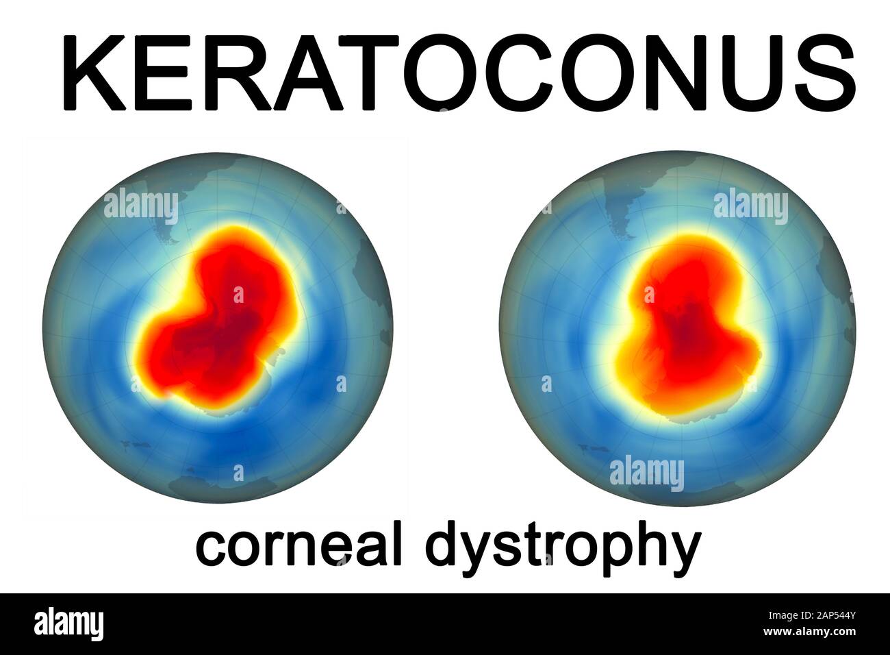 Corneal Disease High Resolution Stock Photography and Images - Alamy