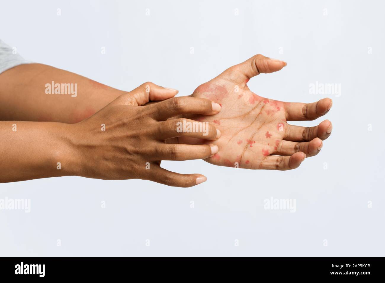 Psoriasis black skin hi-res stock photography and images - Alamy