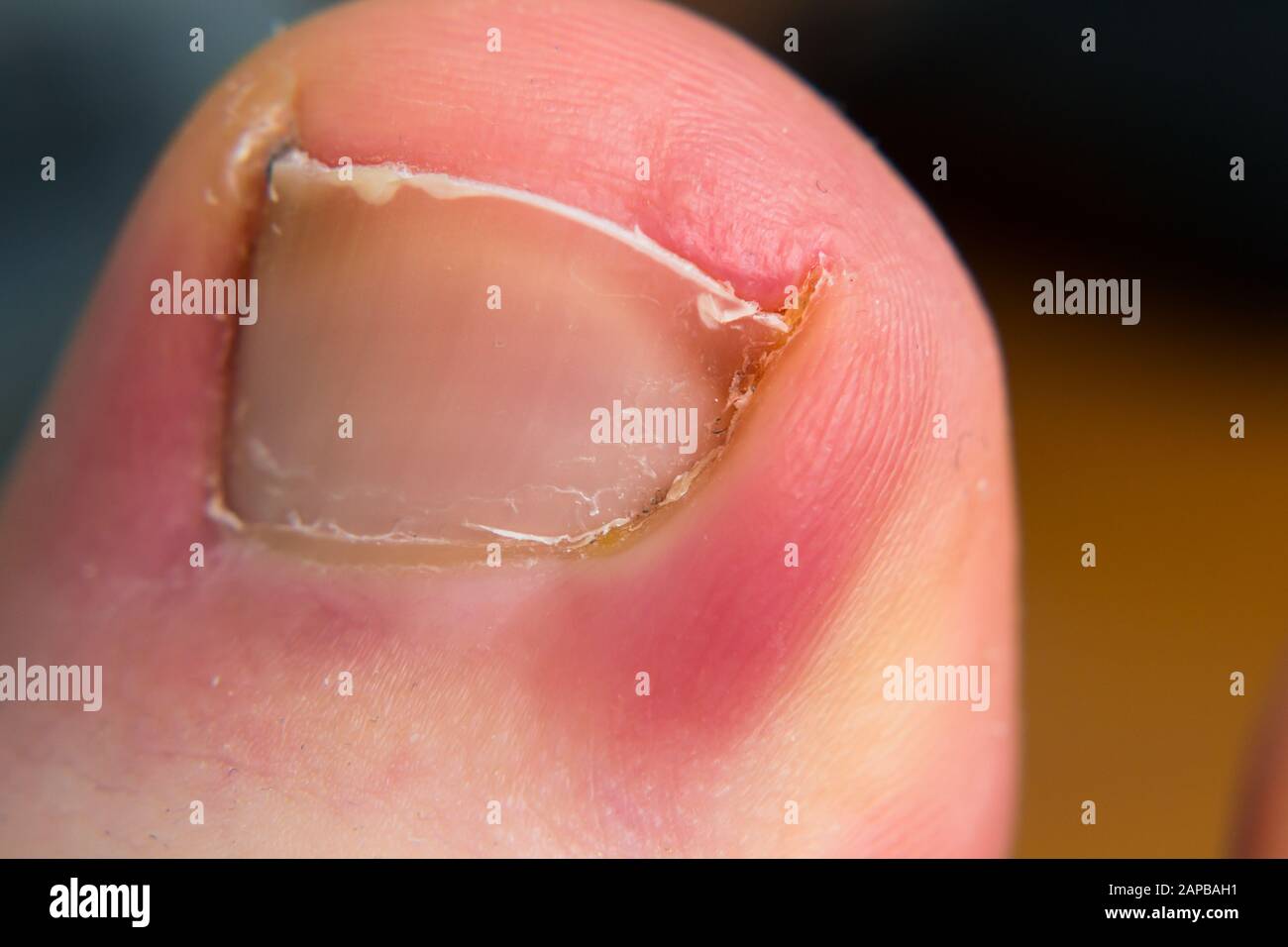 Medical photo of ingrown toenail hi-res stock photography and images ...