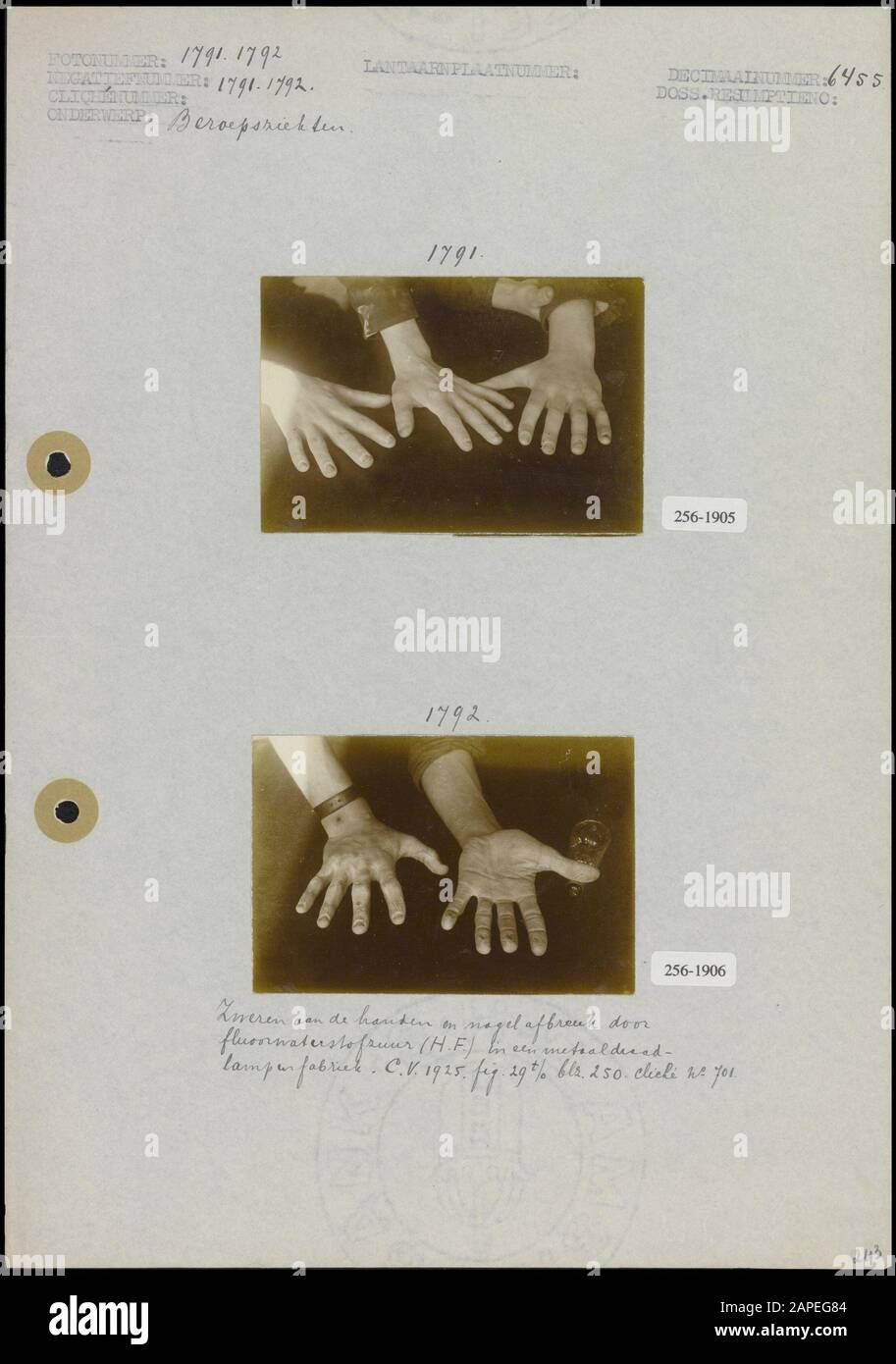 Occupational disease. Photo 1: Hand ulcers and nail damage caused by ...