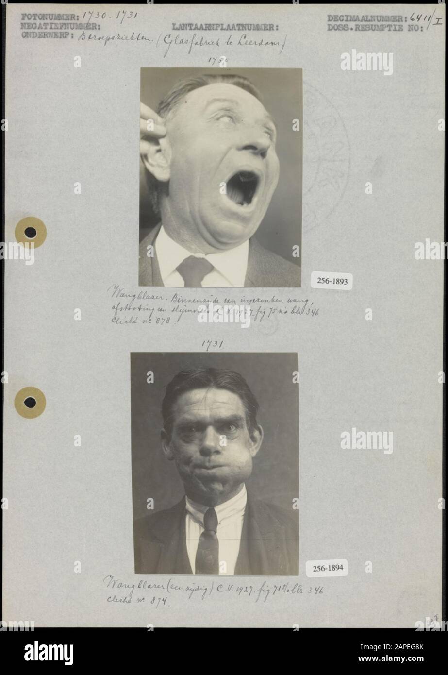 Description: Cheek disorders of glassblowers of the Glasfabriek Leerdam ...
