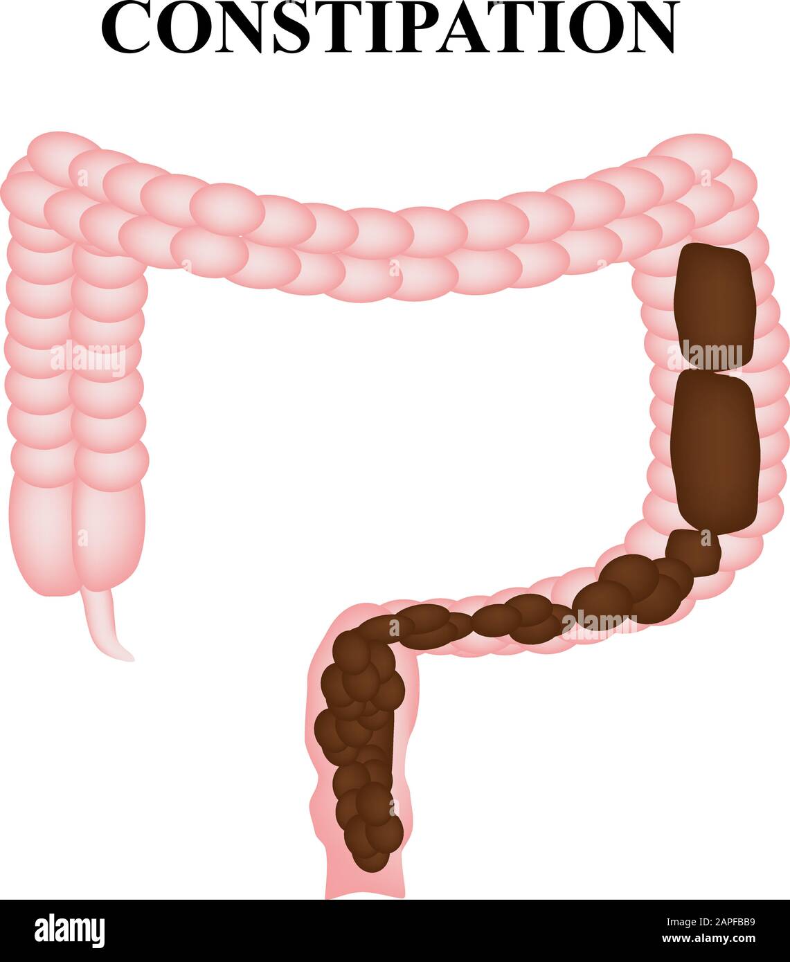 Constipation. Feces in colon. Infographics. Vector illustration on ...