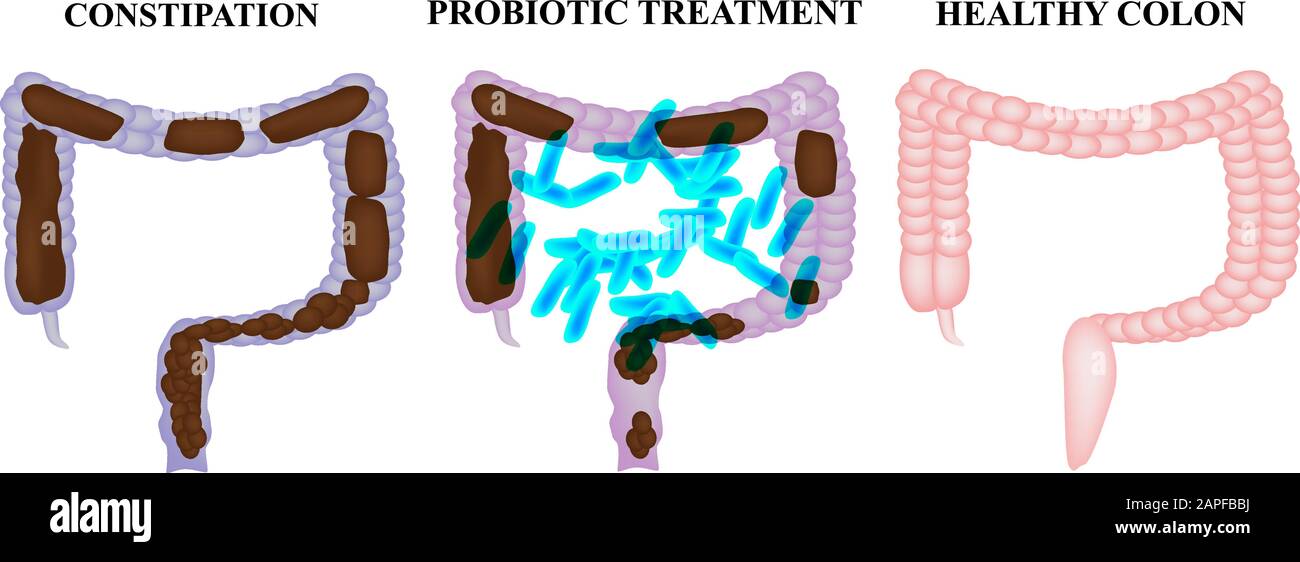 Treatment of constipation with probiotics. Lactobacillus. Feces in ...