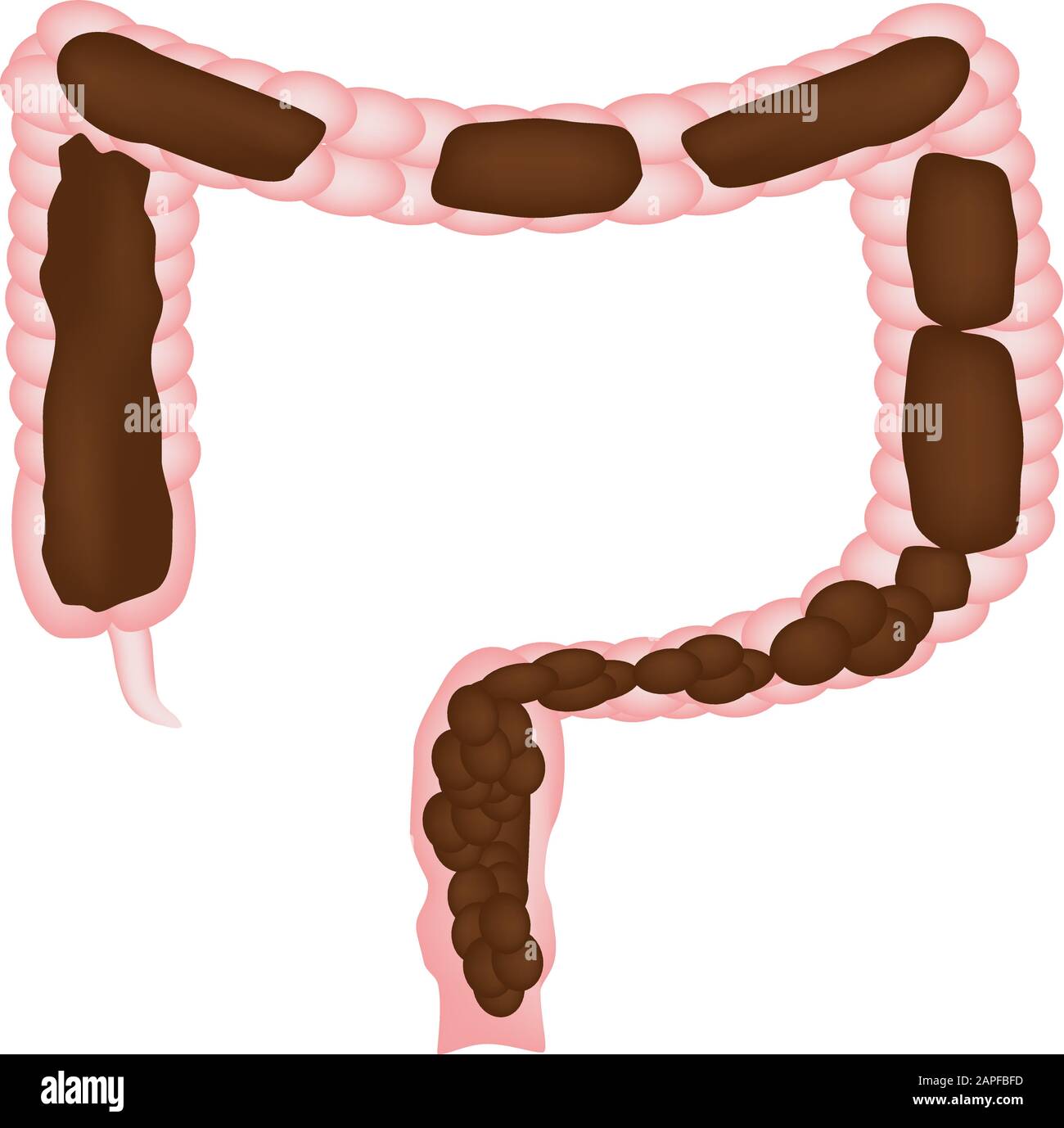 Constipation. Feces in colon. Infographics. Vector illustration on ...