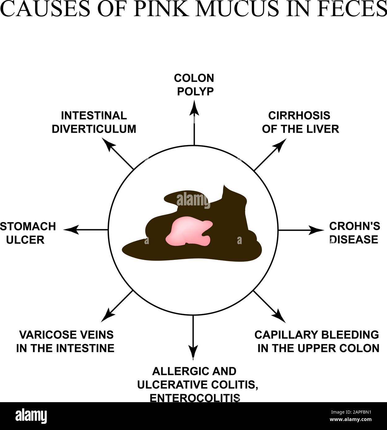 Causes of pink mucus in feces. Diseases of the gastrointestinal tract ...