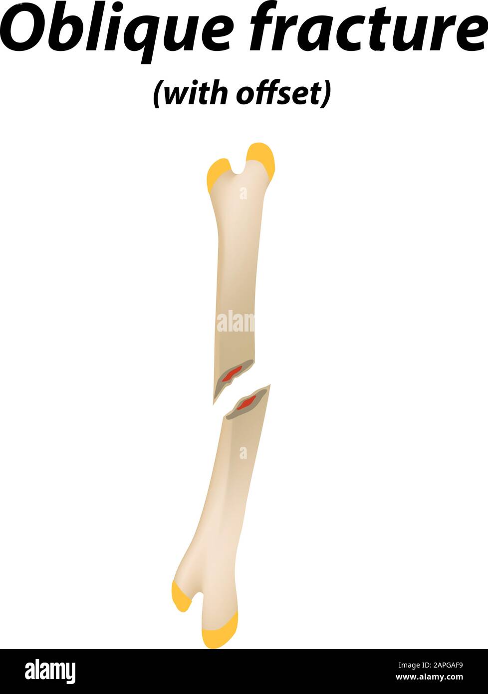 Oblique with offset bone fracture. Infographics. Vector illustration on ...