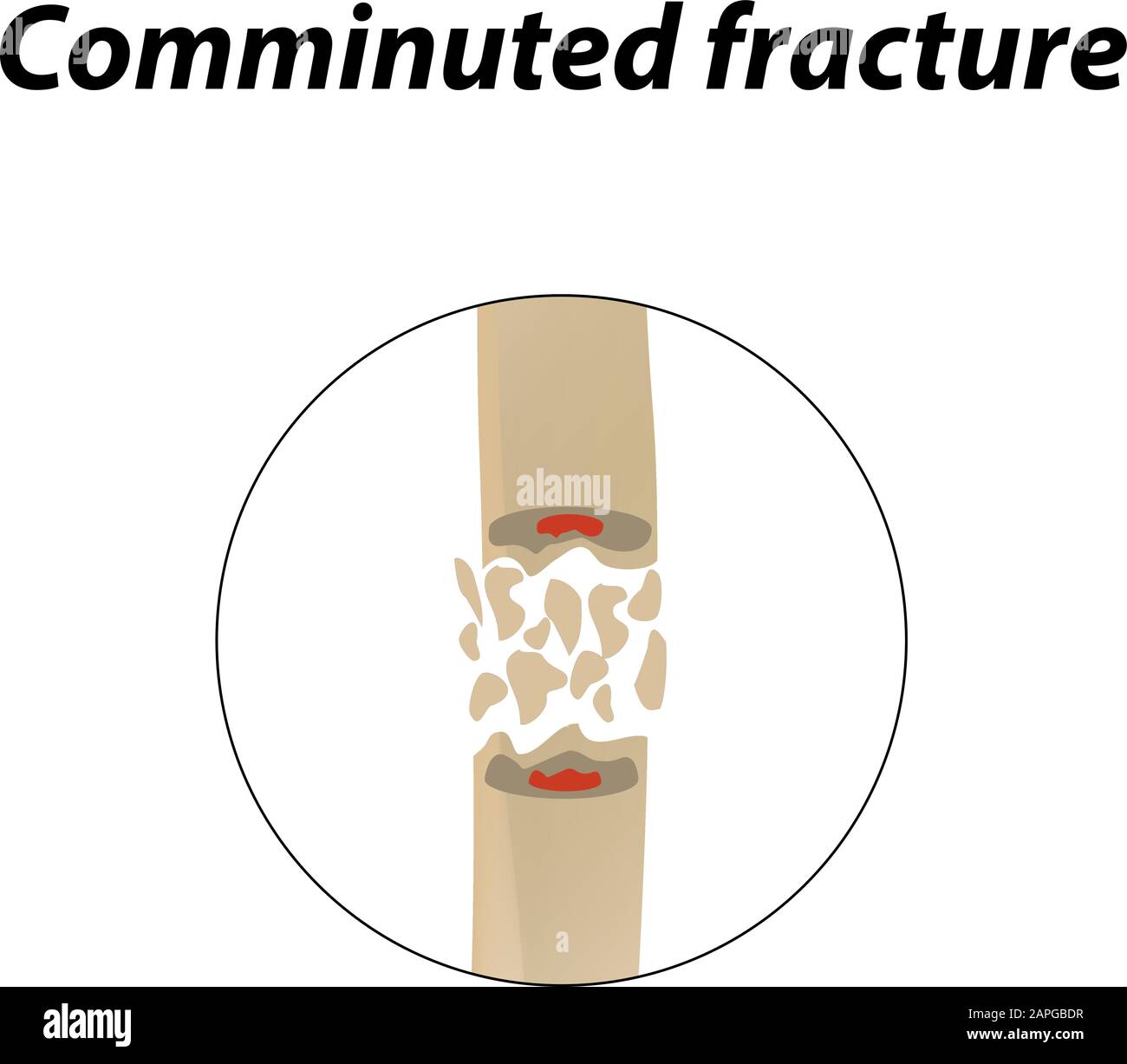 Comminuted fracture hi-res stock photography and images - Alamy