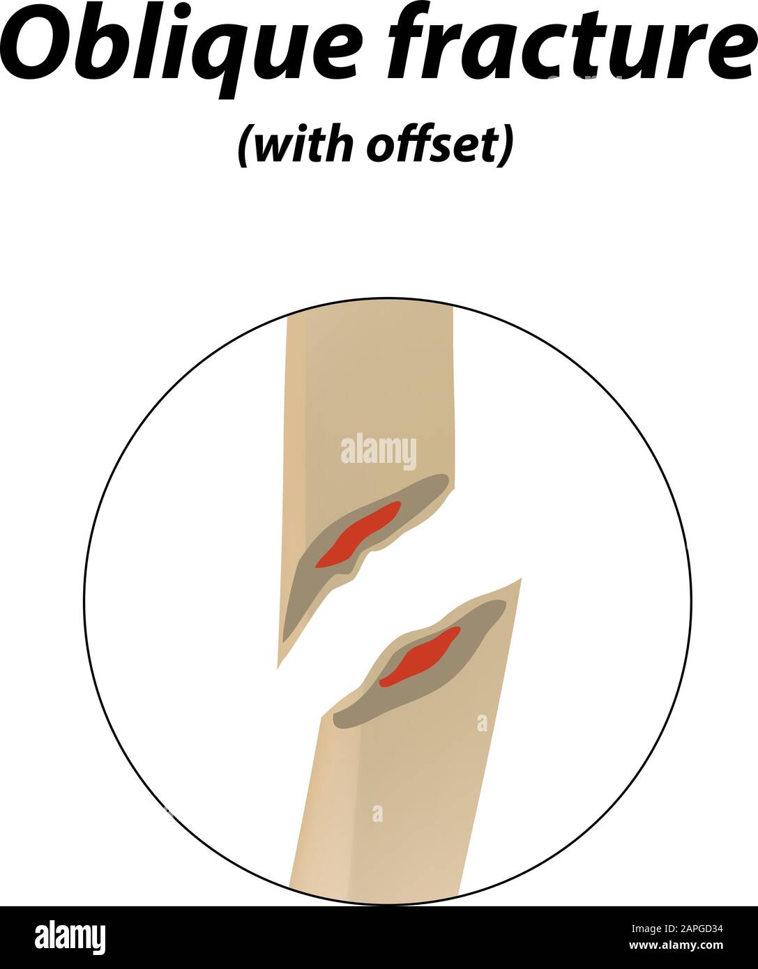 Oblique fracture hi-res stock photography and images - Alamy