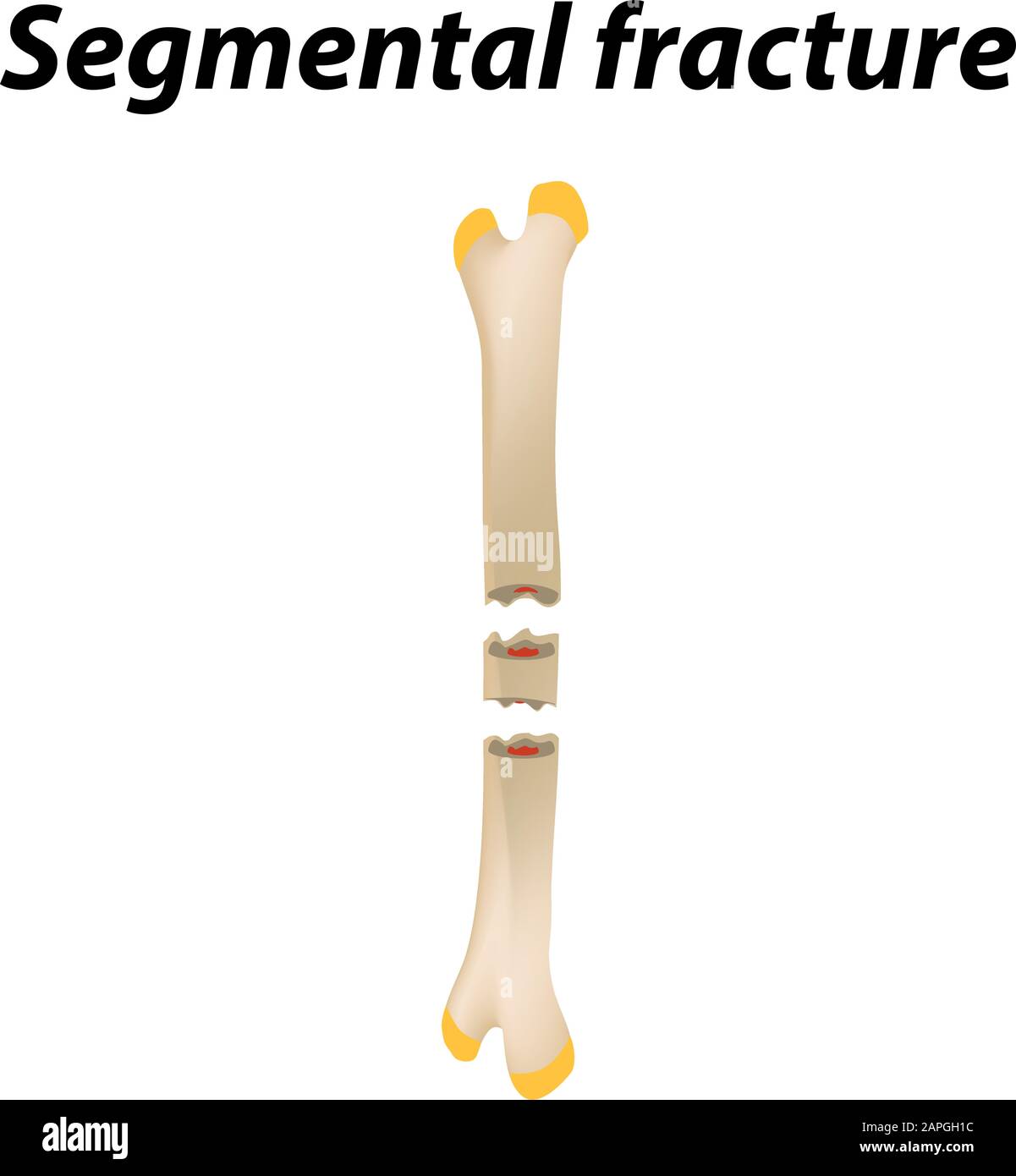 Segmental fracture Bone. Infographics. Vector illustration on a lined ...