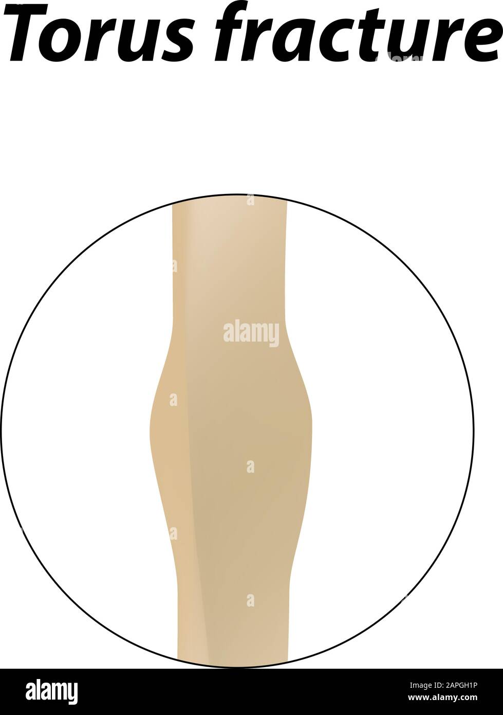 Torus fracture Bone. Infographics. Vector illustration on a lined ...