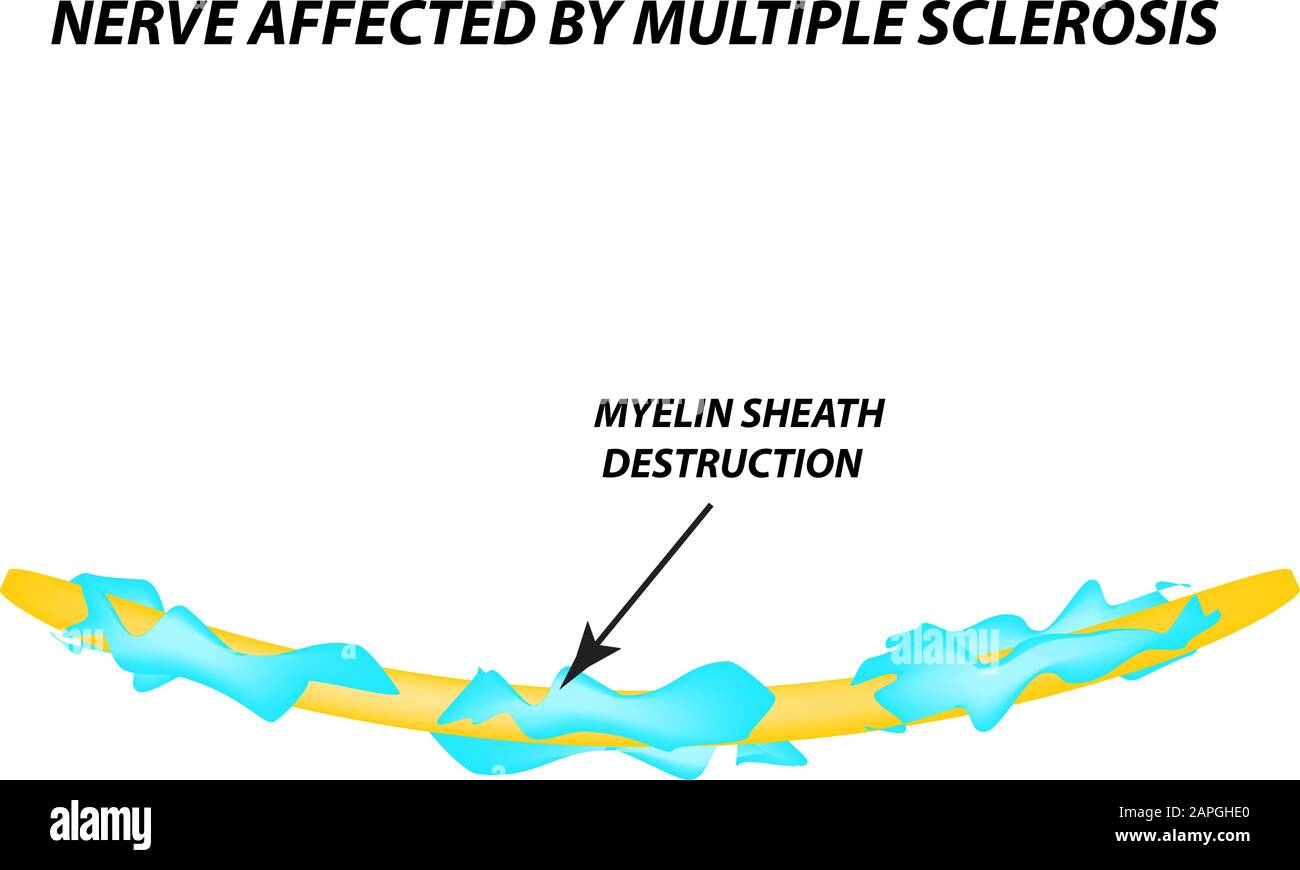 The destruction of the myelin sheath on the axon. Damaged myelin ...