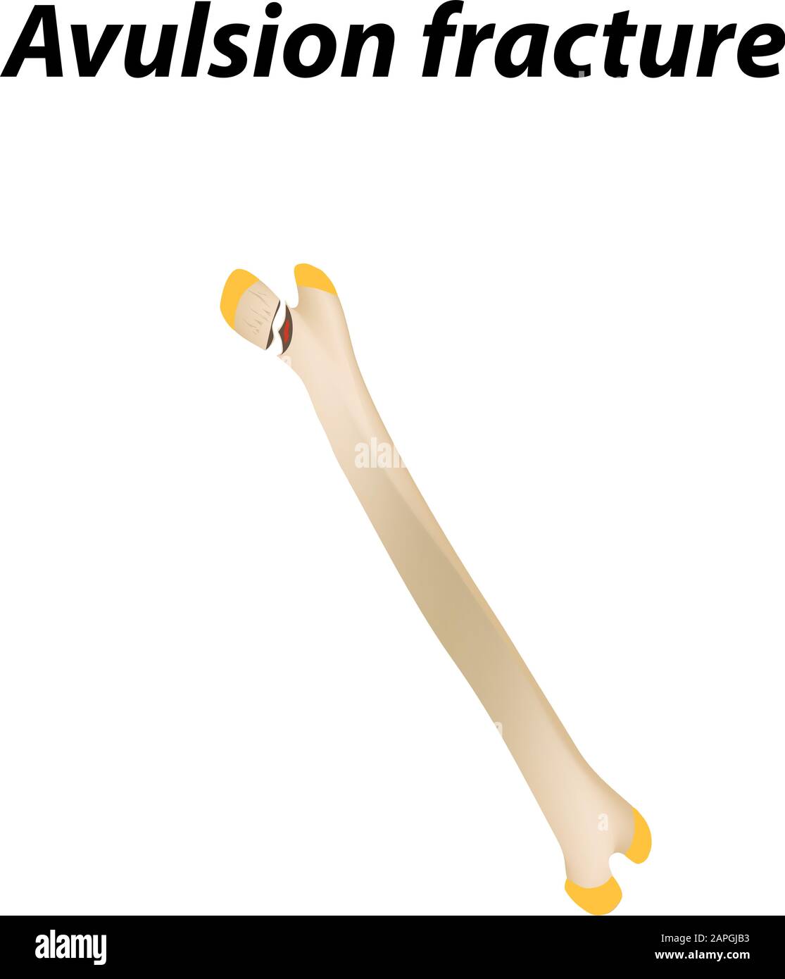 Avulsion Wound Animated