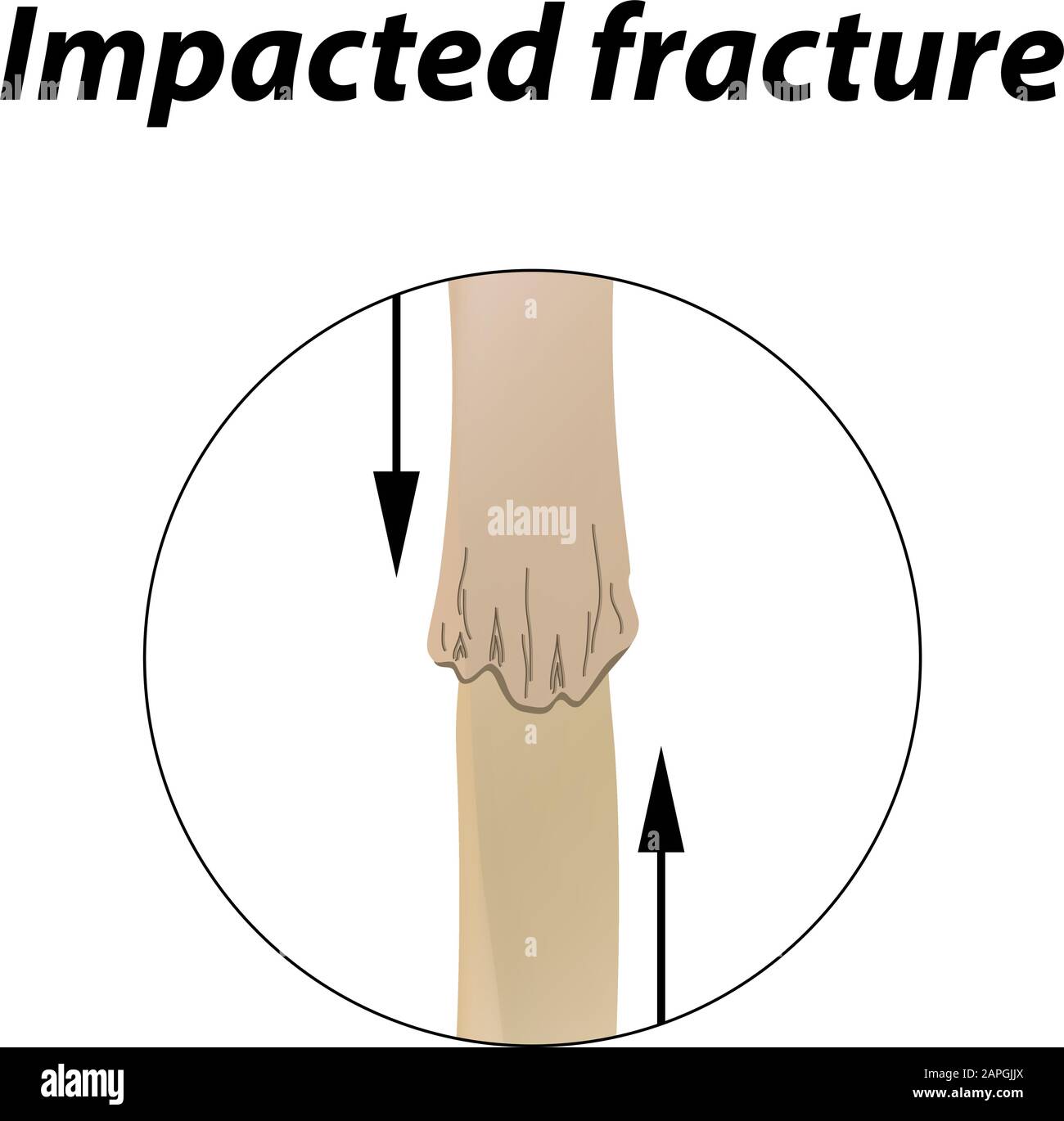 Impacted fracture Bone. Infographics. Vector illustration on a lined ...