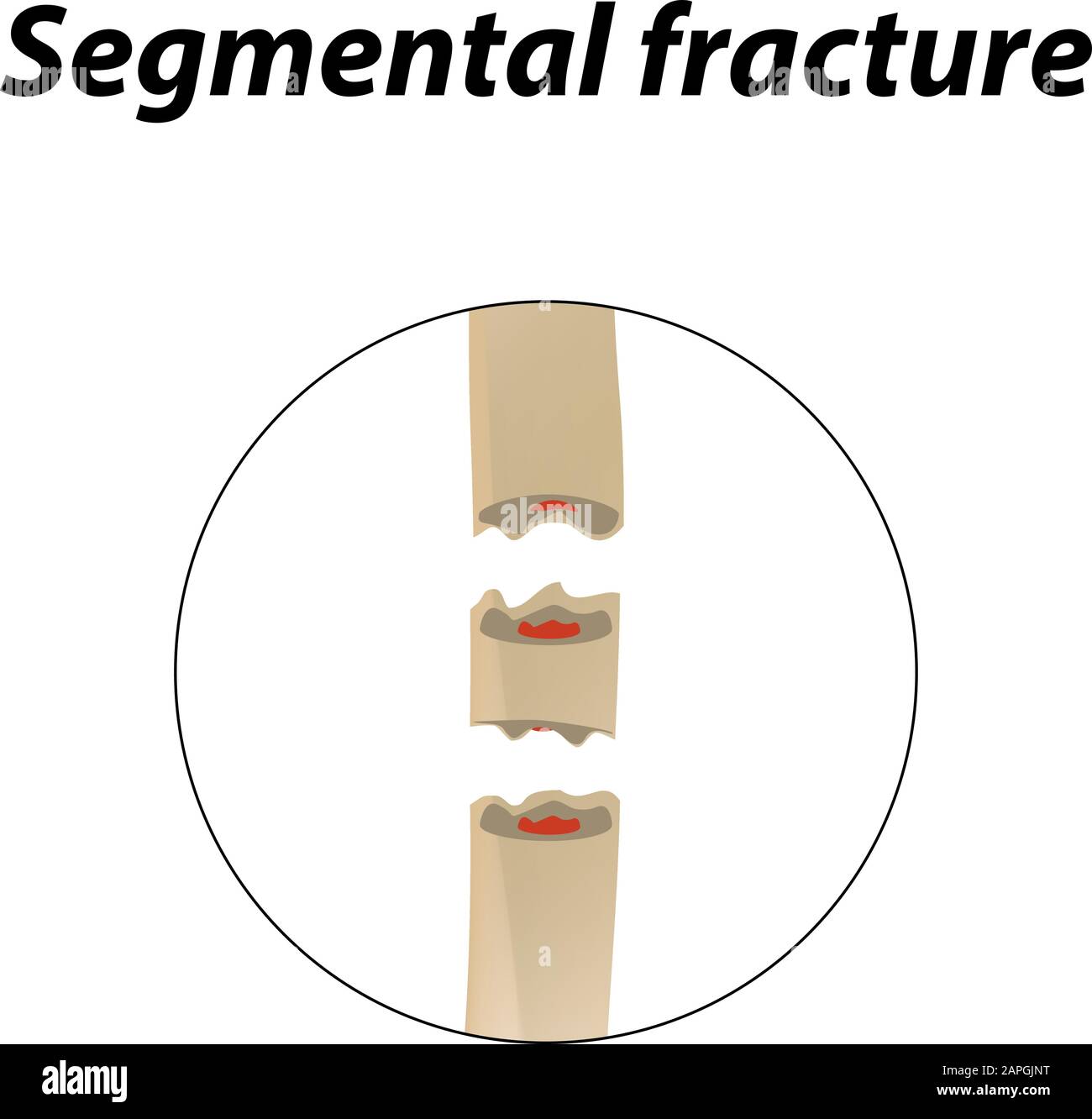 Segmental fracture Bone. Infographics. Vector illustration on a lined ...
