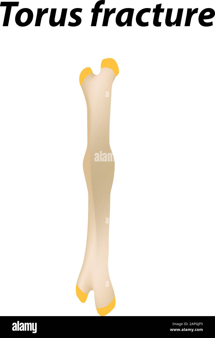 Oblique fracture hi-res stock photography and images - Alamy