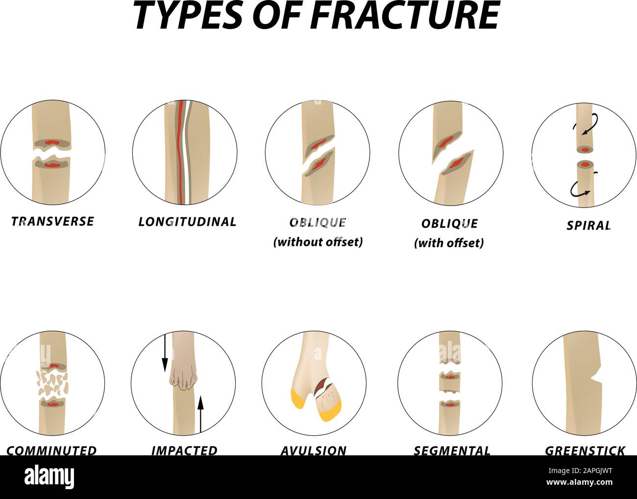 Types of fracture. Fracture bone set. Infographics. Vector illustration ...